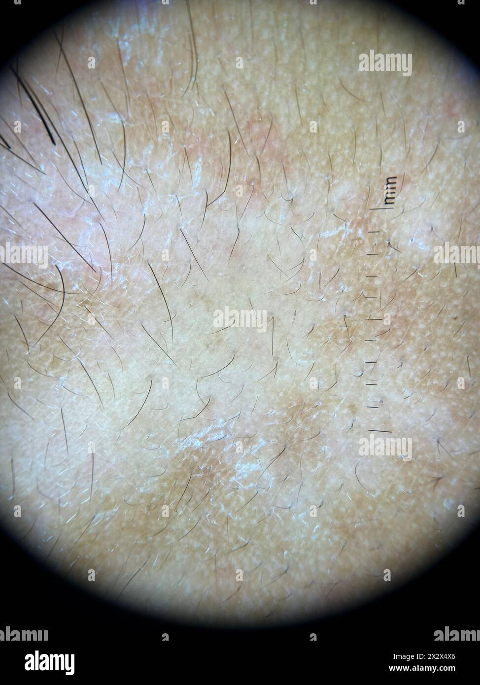 Dermatoscope image of the skin of a patient with seborrheic dermatitis ...