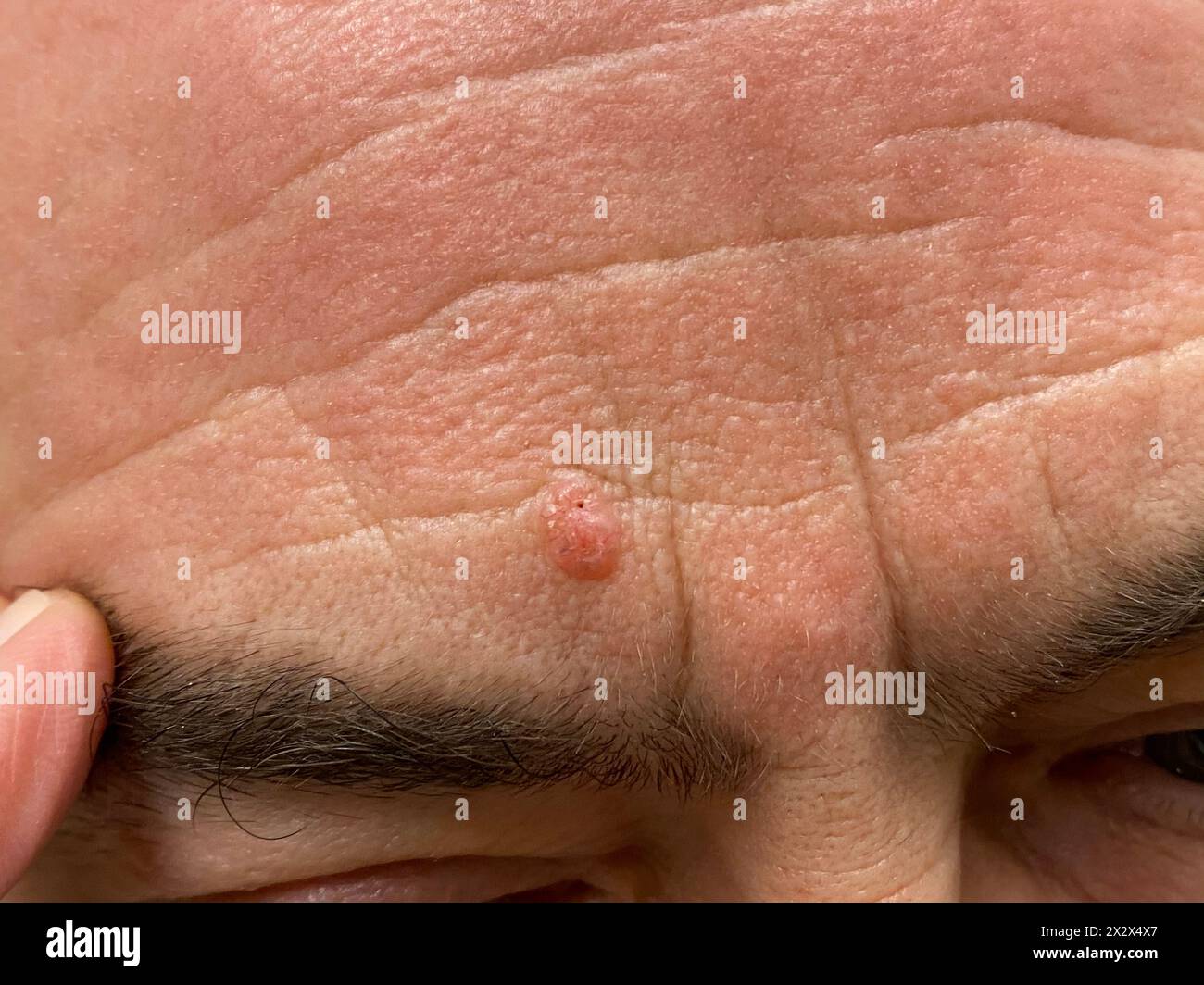 Nodular basal cell carcinoma (BCC), or rodent ulcer, on a 65 year old ...