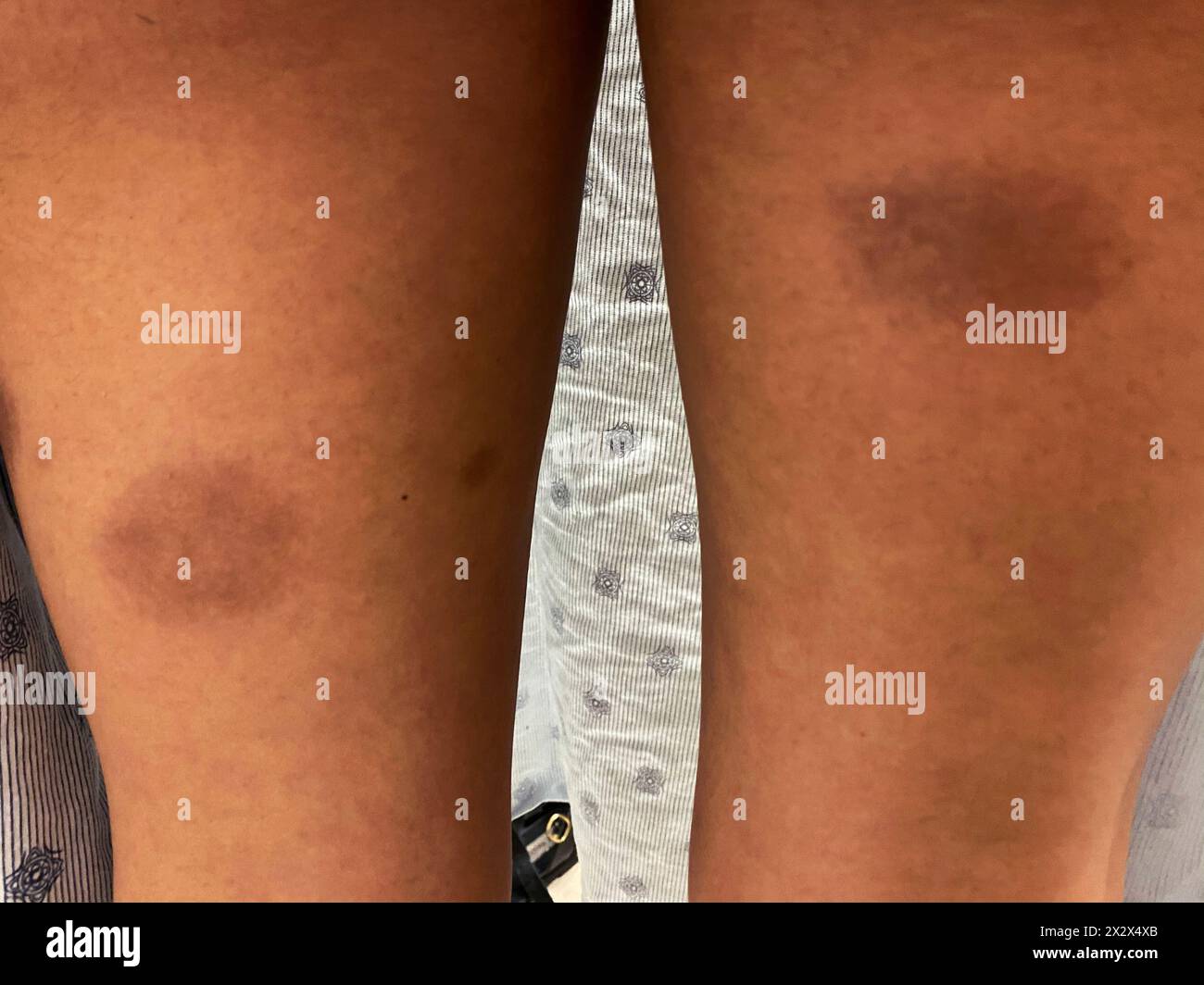 Ashy dermatosis on the legs of a 21 year old Hispanic female patient ...