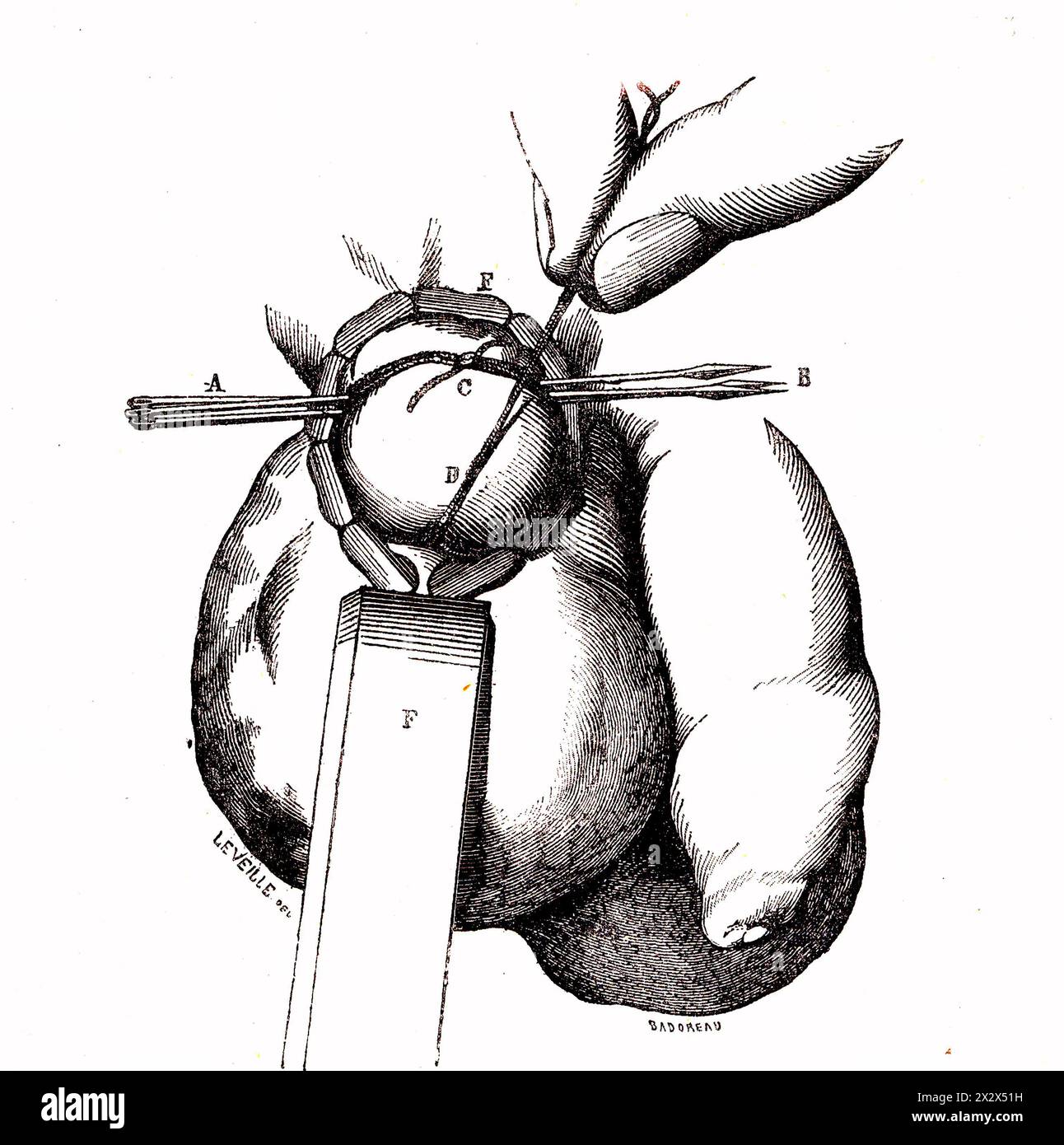 Illustration of surgery to treat varicocele, a form of varicose veins ...
