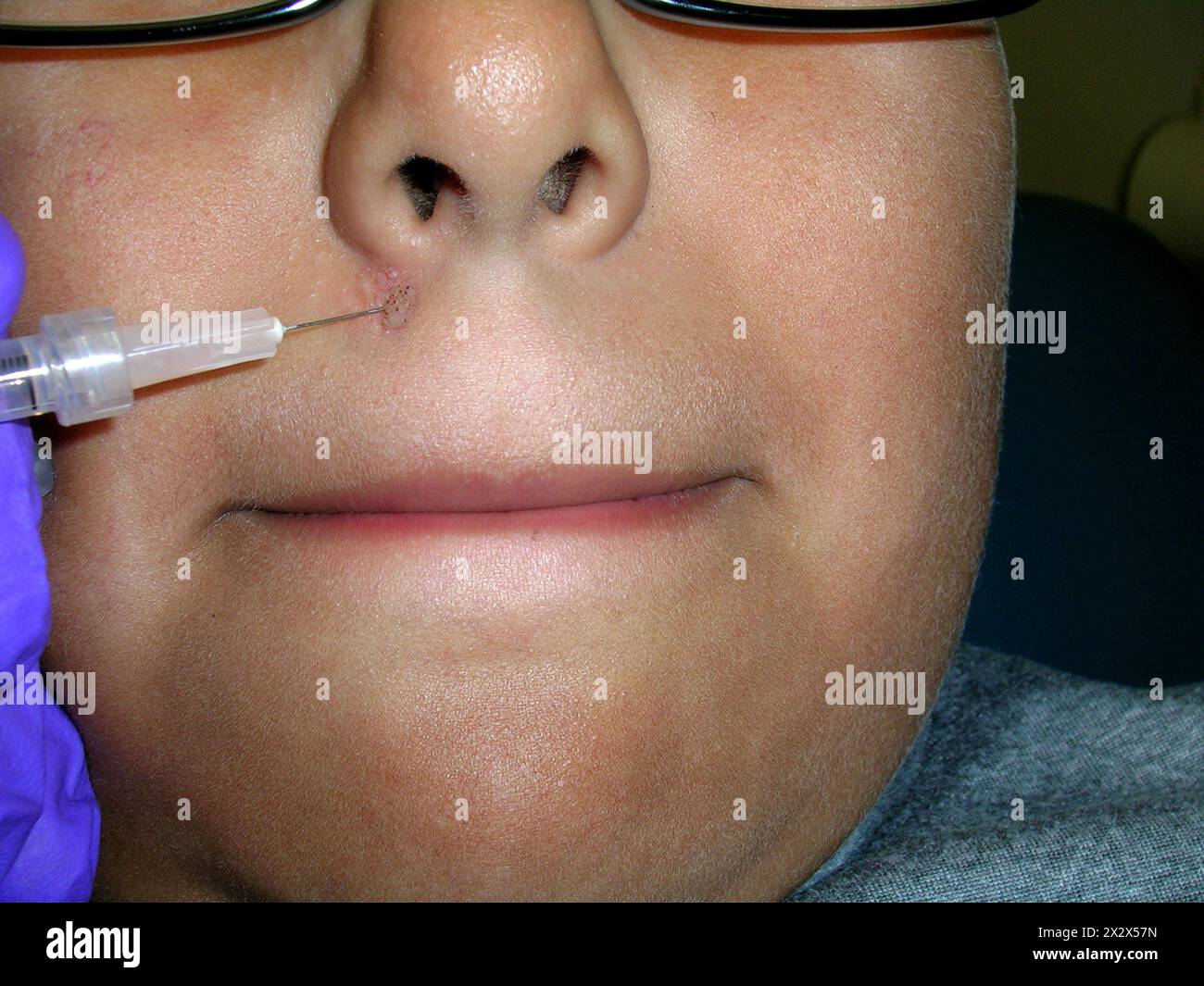 Wart under the nose of a 10 year old Hispanic boy being injected with Candida antigen therapy ...