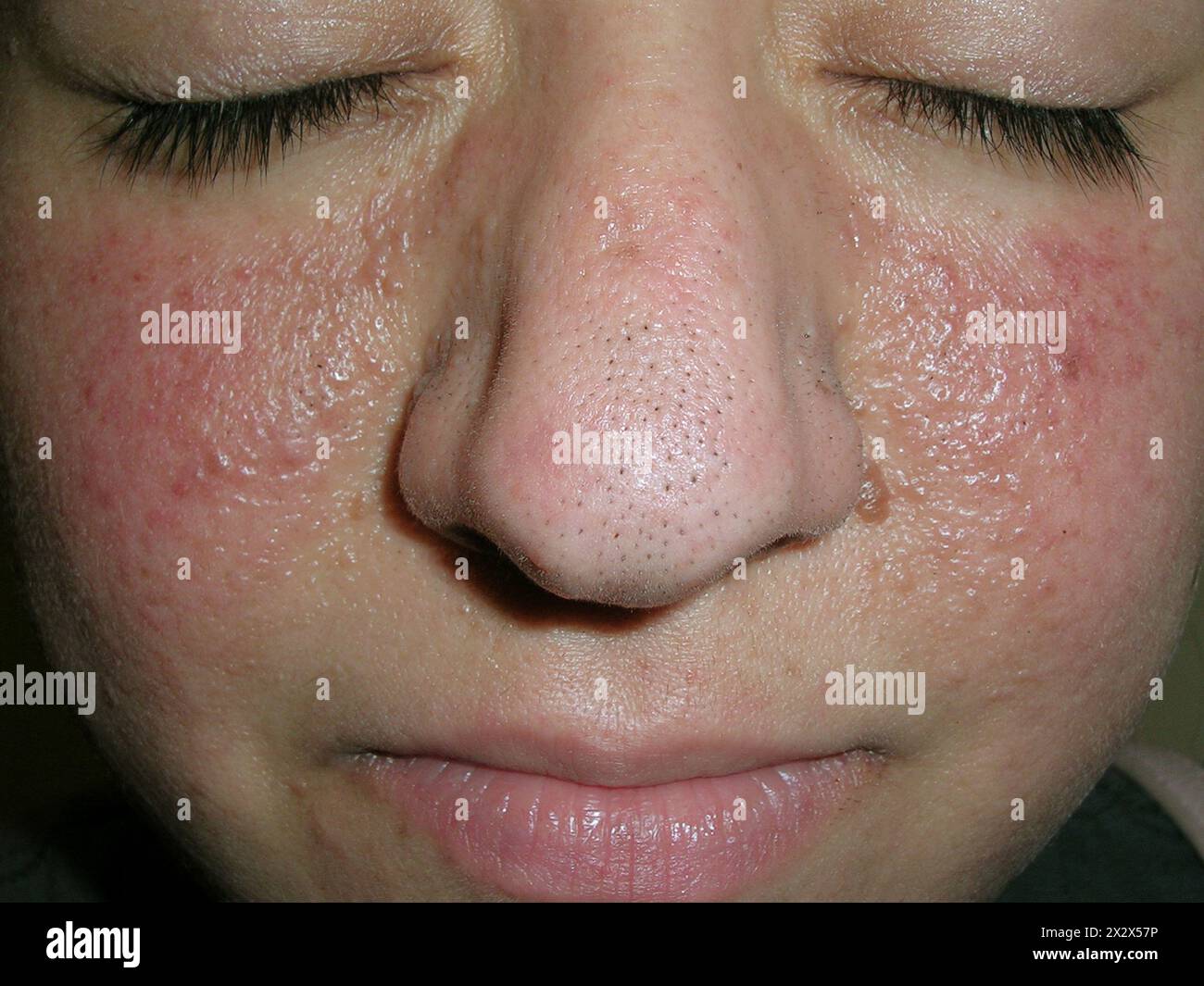 Face of a patient with skin lesions (cutaneous angiofibromas) caused by ...