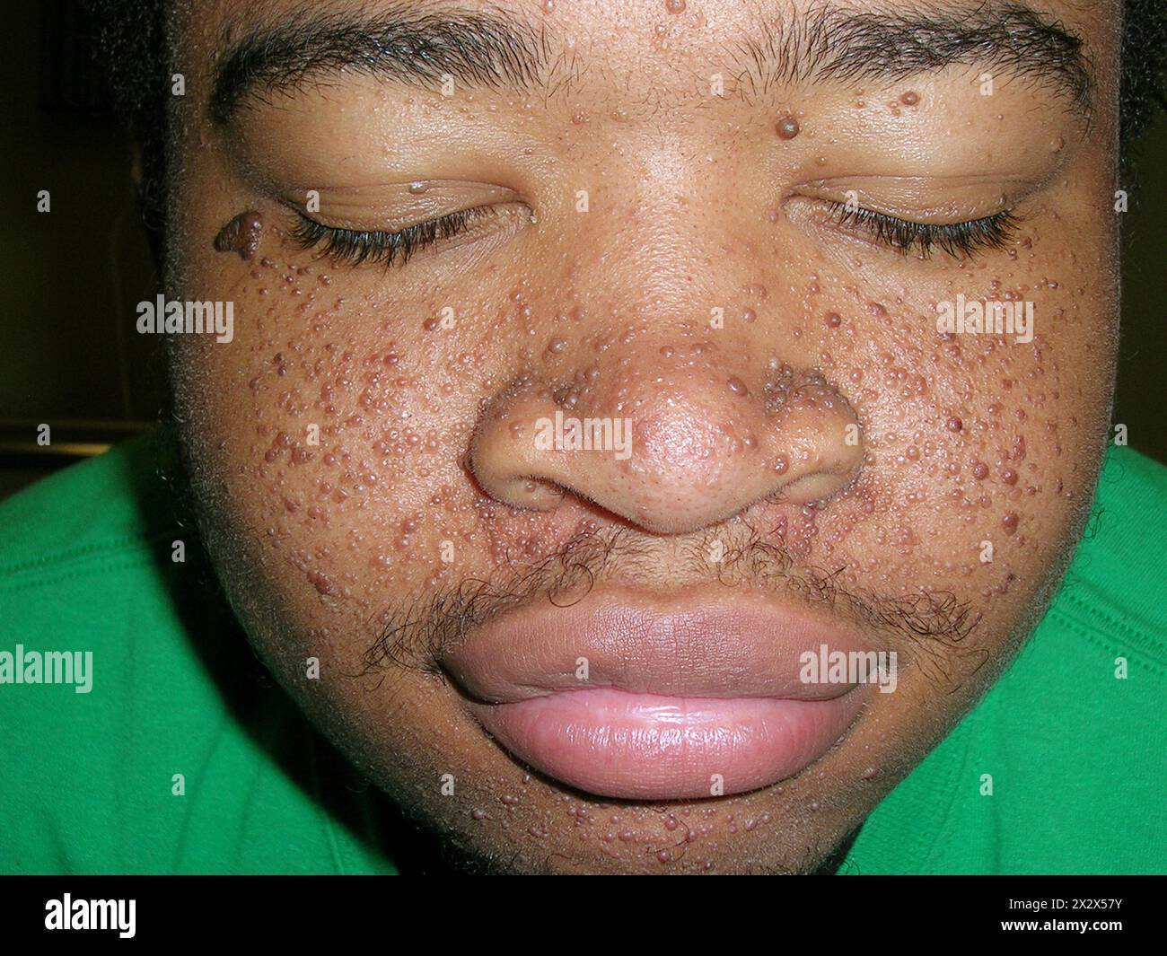 Face of a 22 year old African American male with skin lesions ...