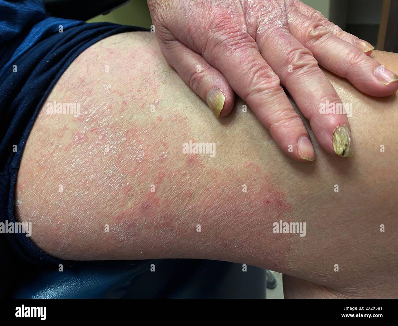 Ringworm infection on the thigh and hand of a 65 year old white male ...