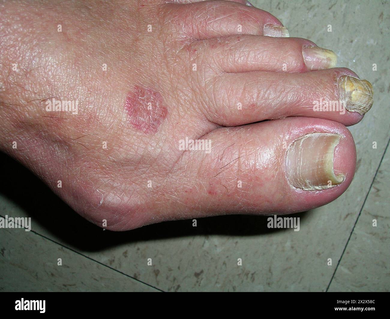 Athlete's foot, or tinea pedis, is a form of ringworm, a disease caused ...
