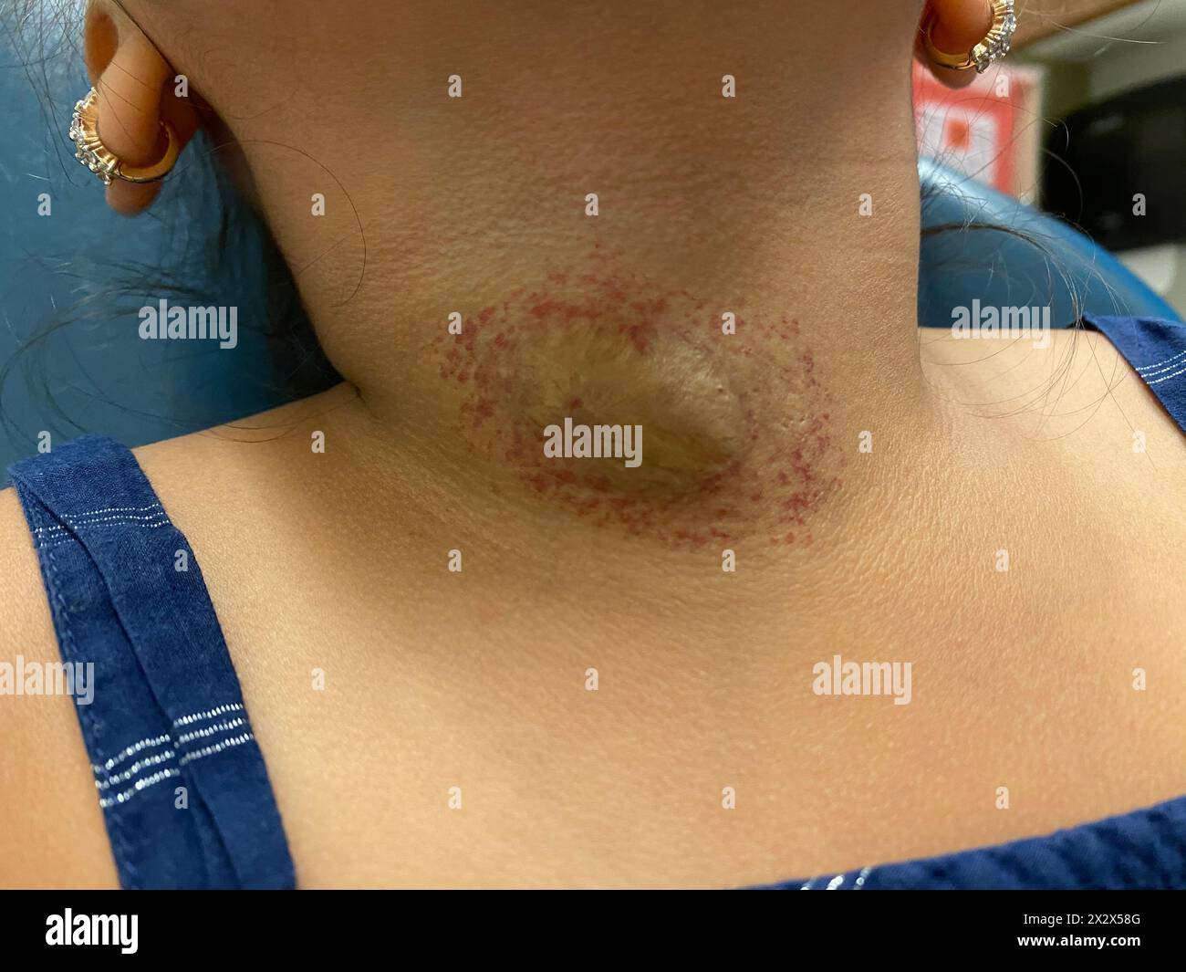 Involuting infantile haemangioma on the neck of a three year old ...