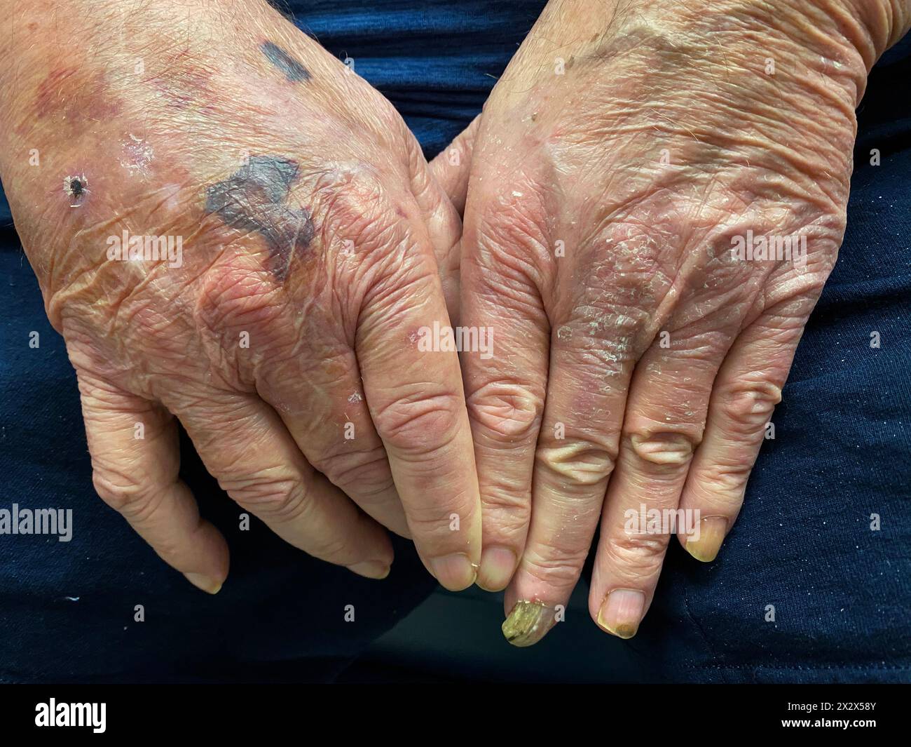 Ringworm infection on the left hand (right) of a 65 year old white male ...