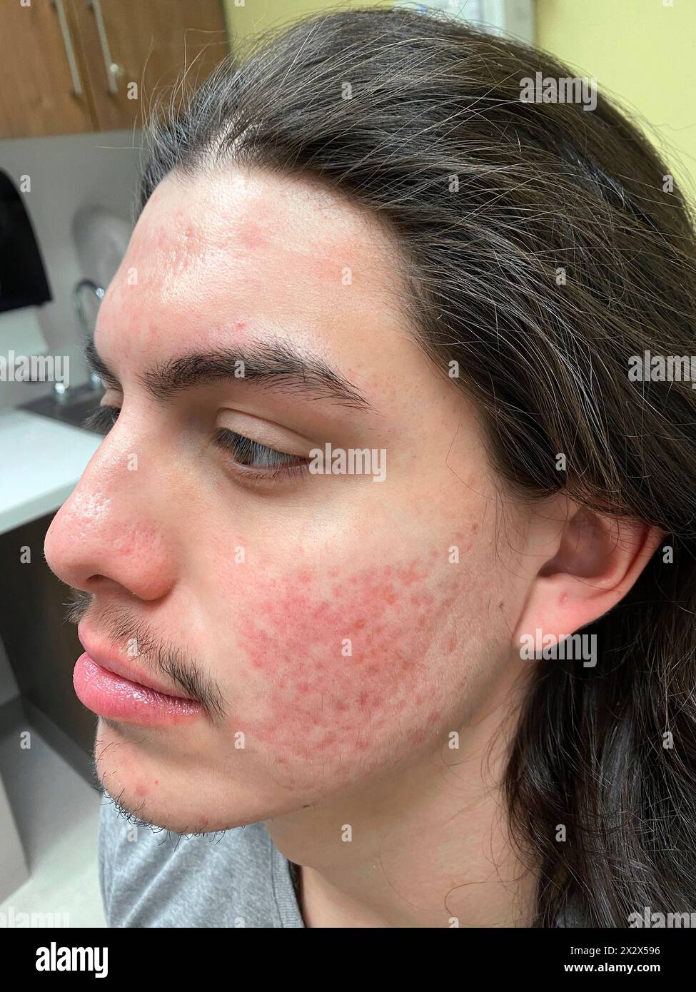 Editorial use only Face of a 21 year old Hispanic male patient with ...