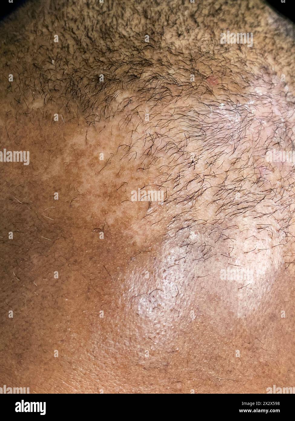 Scalp of an African American female patient with seborrheic dermatitis ...