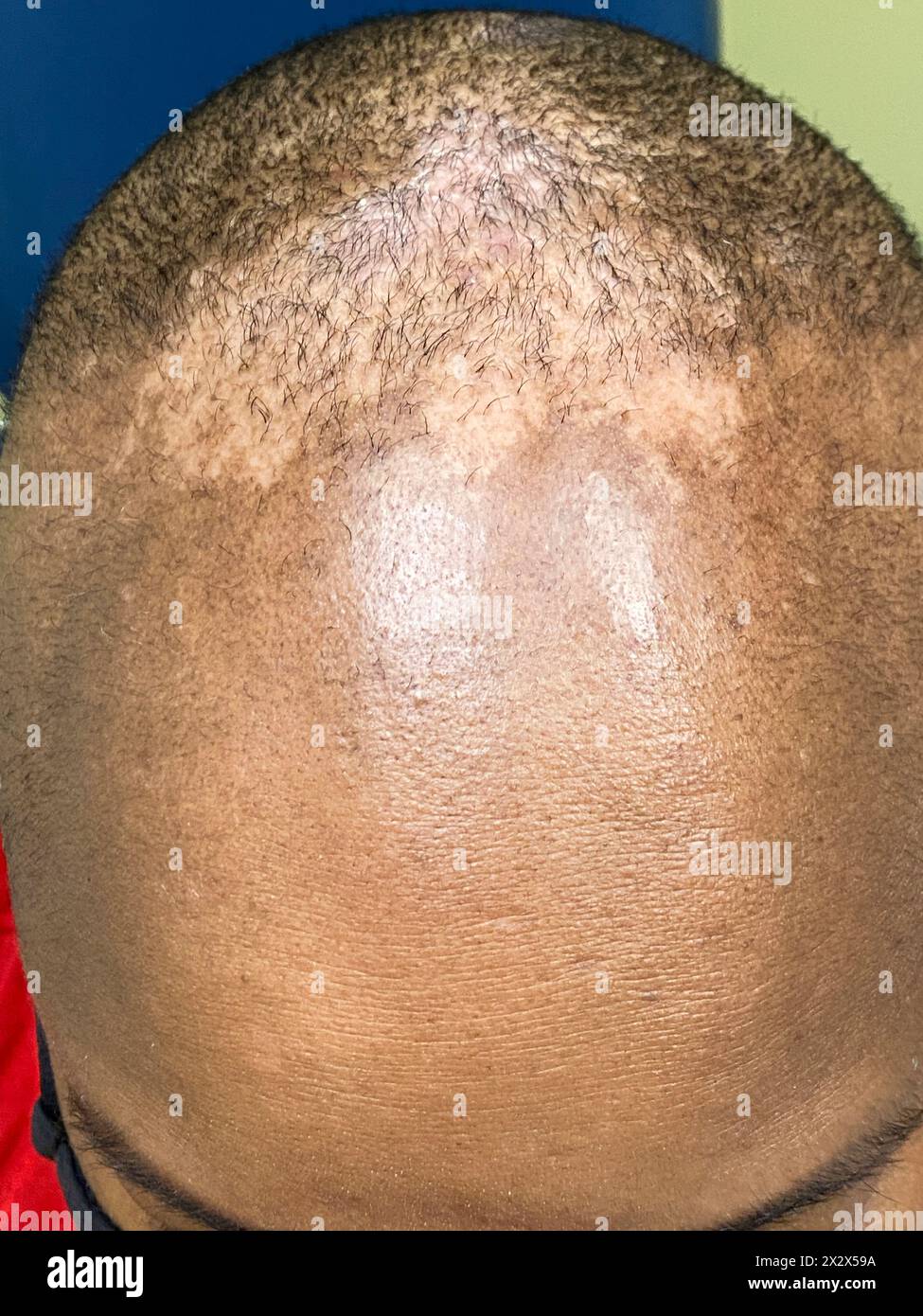 Scalp of an African American female patient with seborrheic dermatitis ...