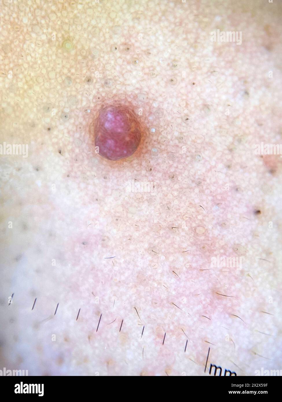 Dermatoscope image of an angiofibroma on the skin of a 9 year old ...