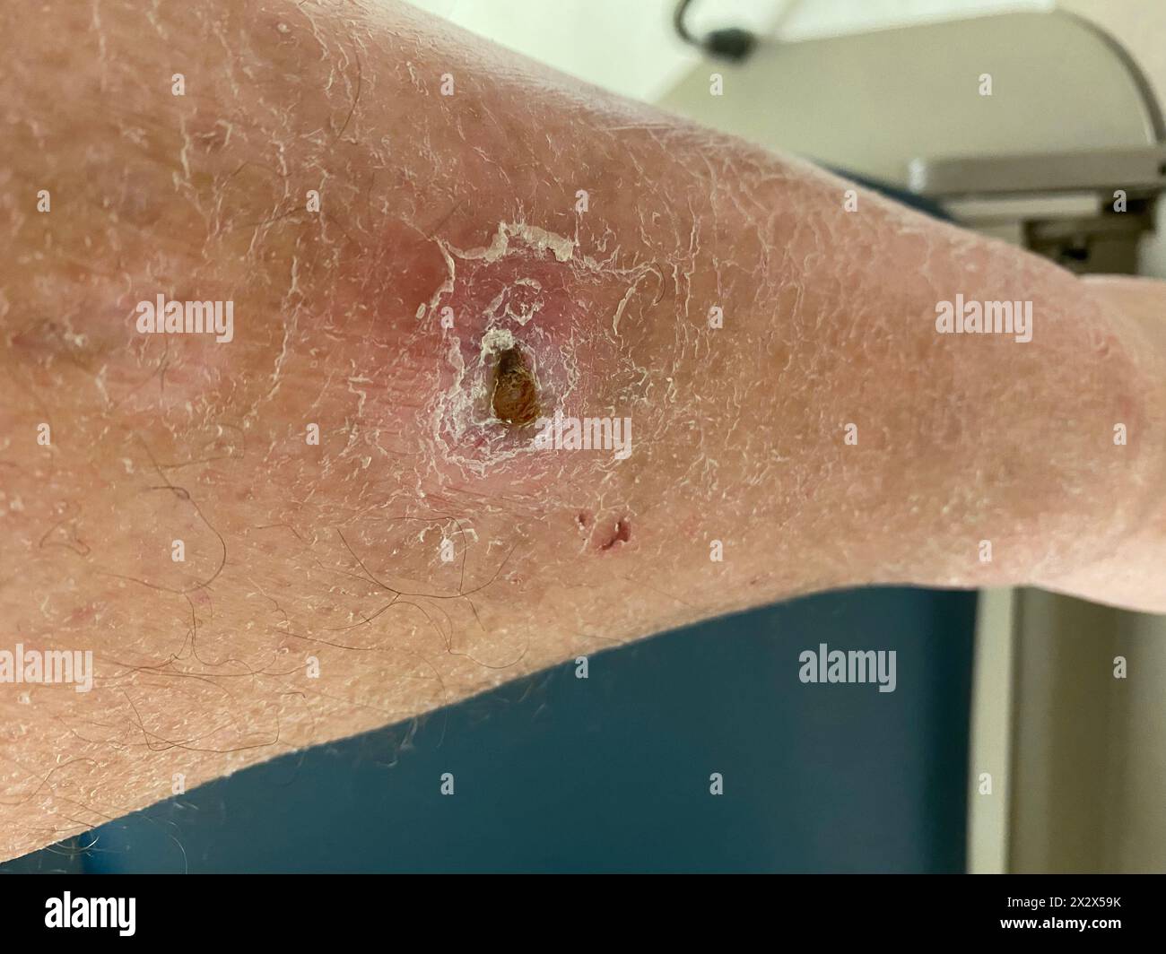 Ringworm on the arm of a 65 year old white male patient. Ringworm is a ...