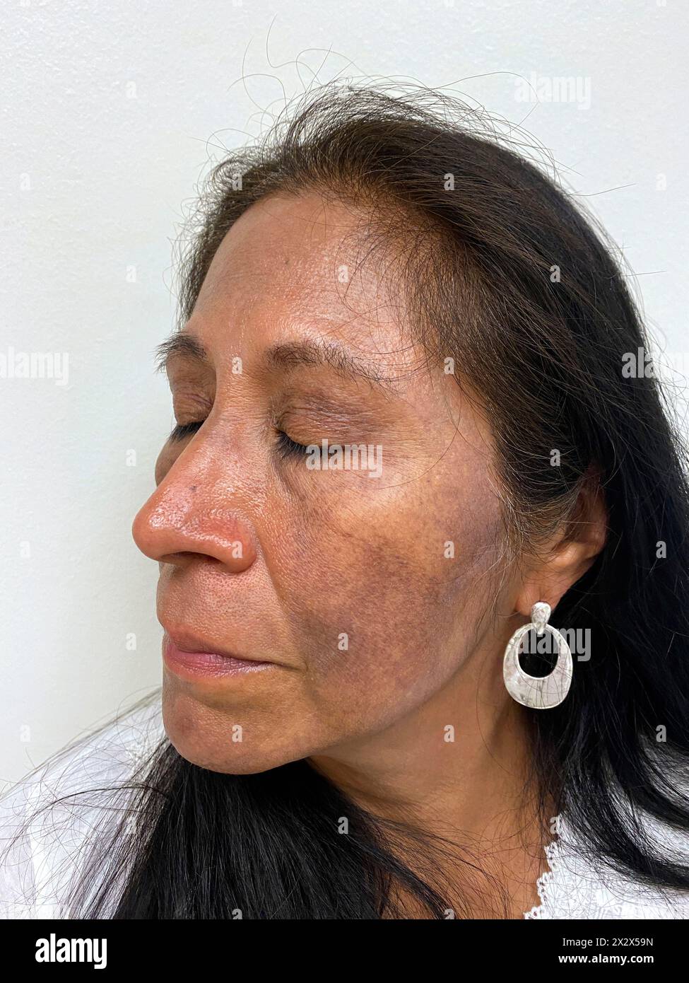 Ashy dermatosis on the face of a 45 year old Hispanic female patient ...