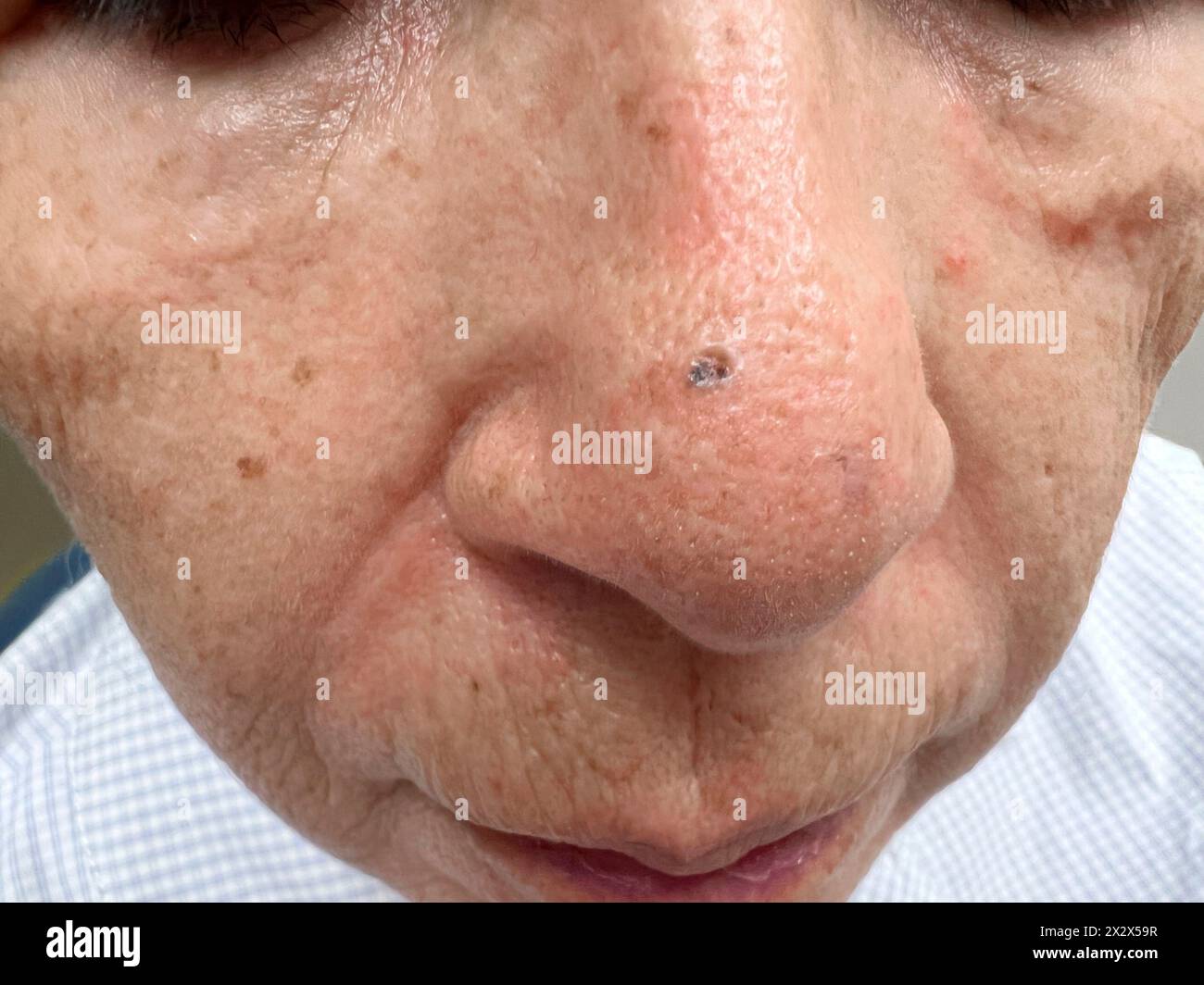 Pigmented basal cell carcinoma (BCC), or rodent ulcer, on a Hispanic ...