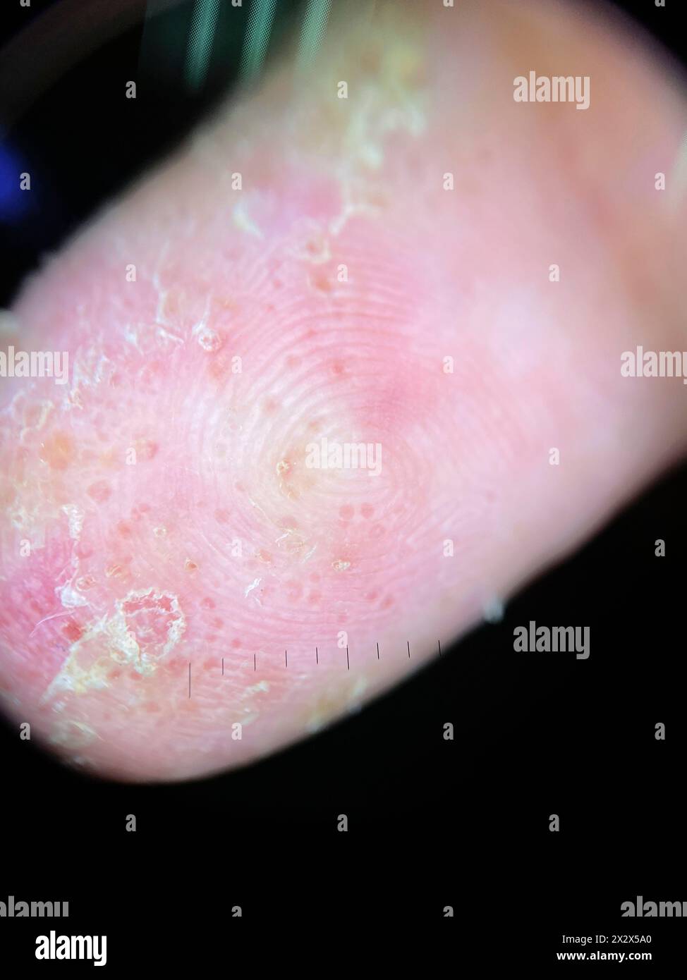 Dermatoscope image of dyshidrotic eczema on the thumb of a 50 year old ...