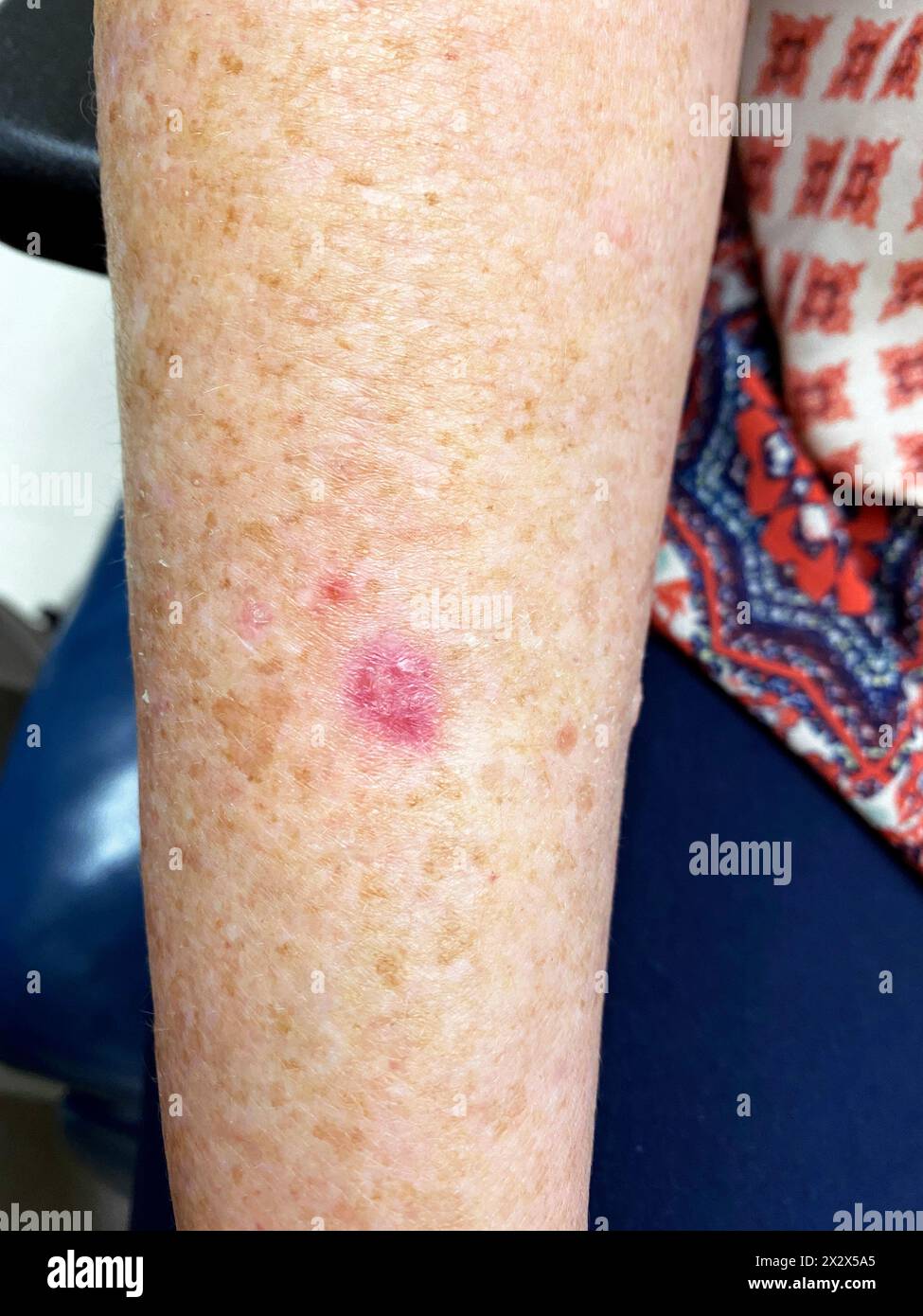 Nodular basal cell carcinoma (BCC), or rodent ulcer, on a patient's arm ...