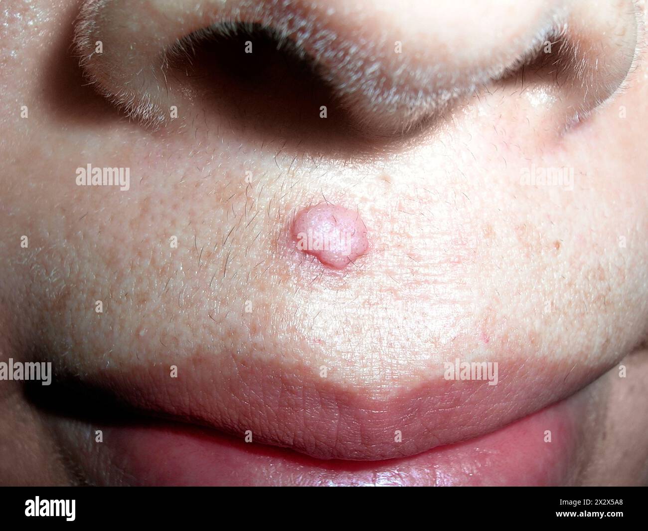 Wart on the face of a 27 year old female Hispanic patient. Warts are ...