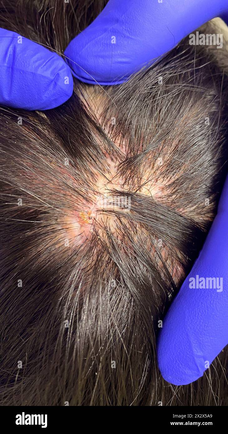 Dissecting cellulitis. This scalp condition is a chronic suppurative ...