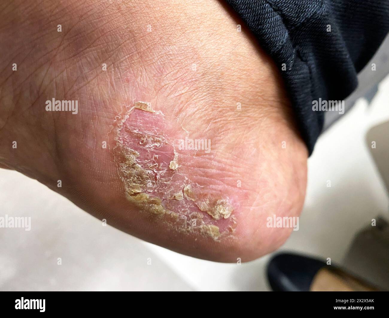 Dyshidrotic eczema on the foot of a 50 year old female Hispanic patient ...