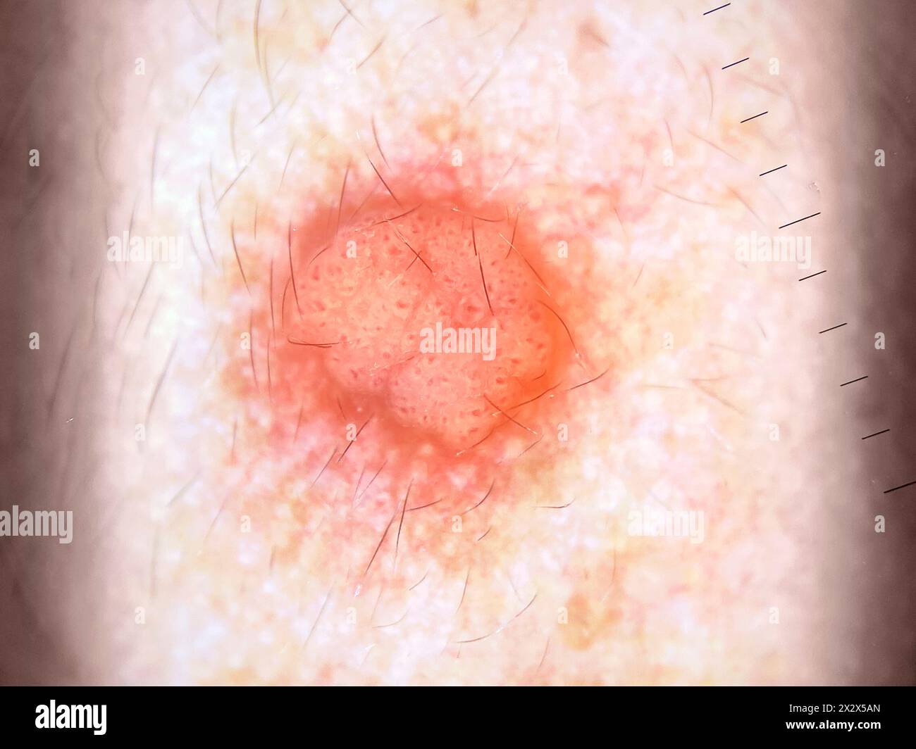 Dermatoscope image of a wart on the face of a 27 year old female ...