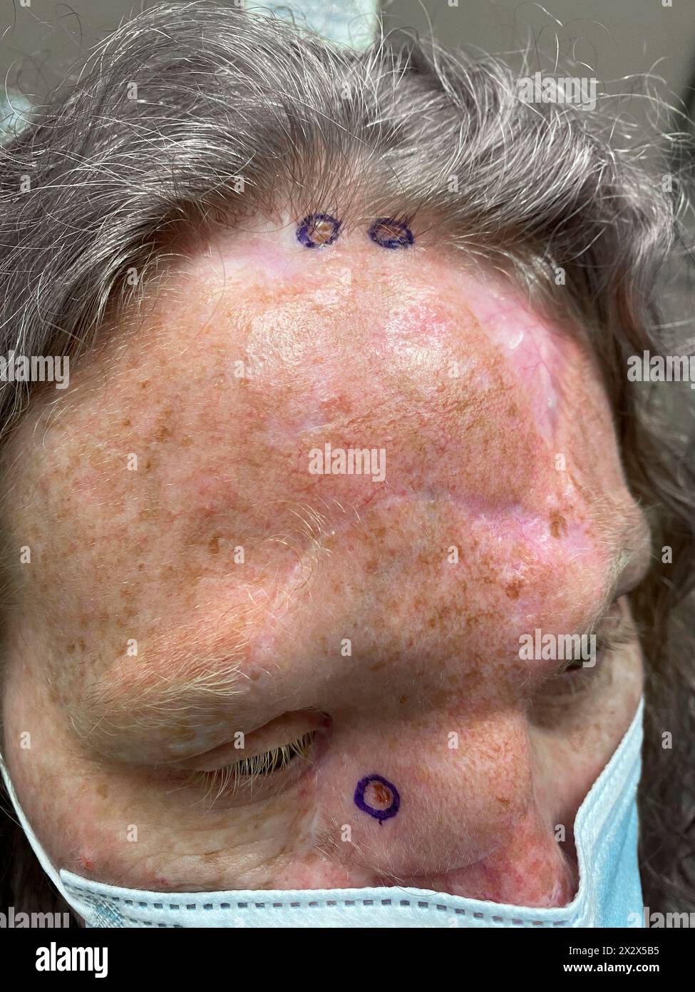 New basal cell carcinomas (BCCs), or rodent ulcers (circled), on the ...