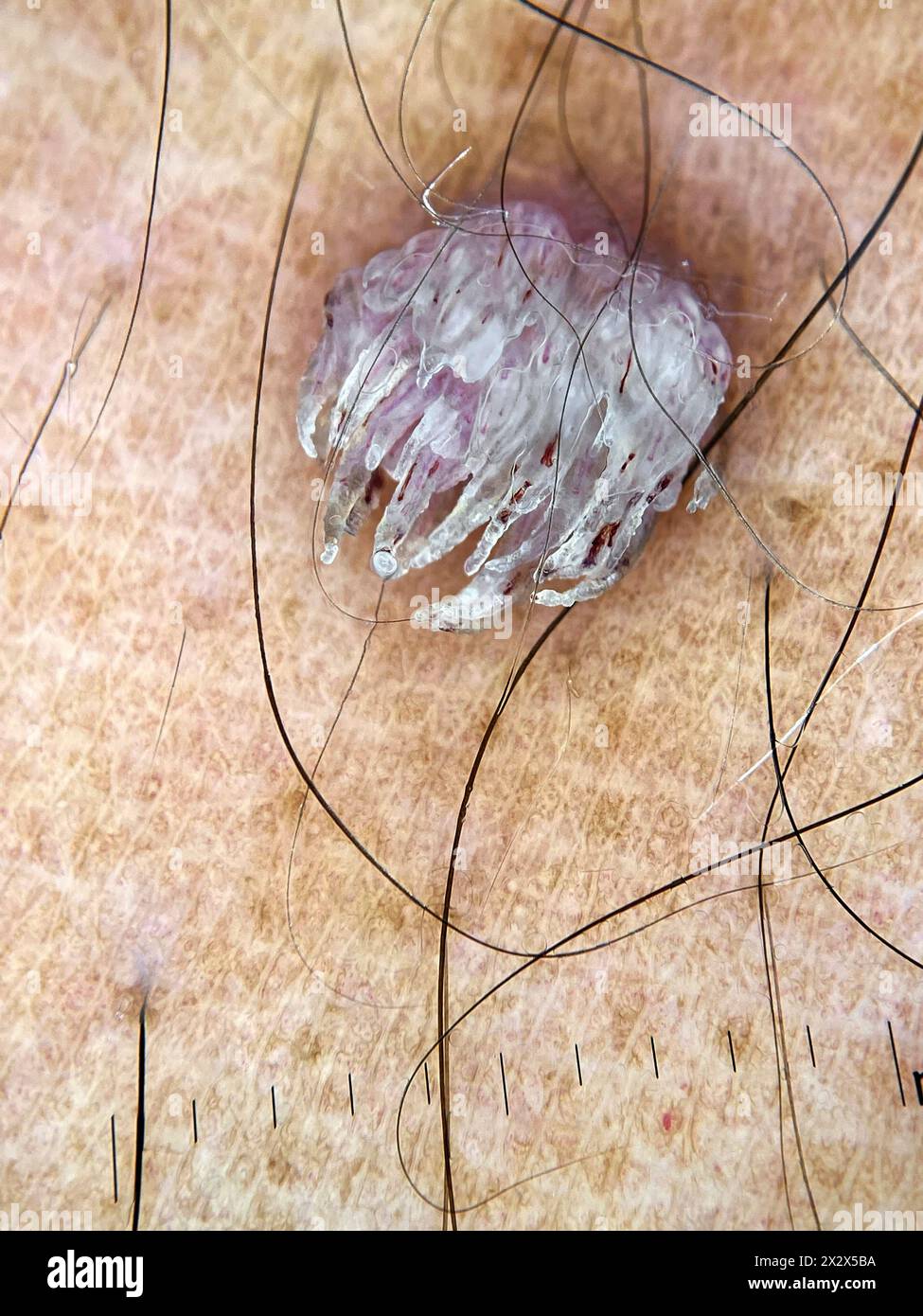 Dermatoscope image of a filiform wart on the arm of a 55 year old male ...