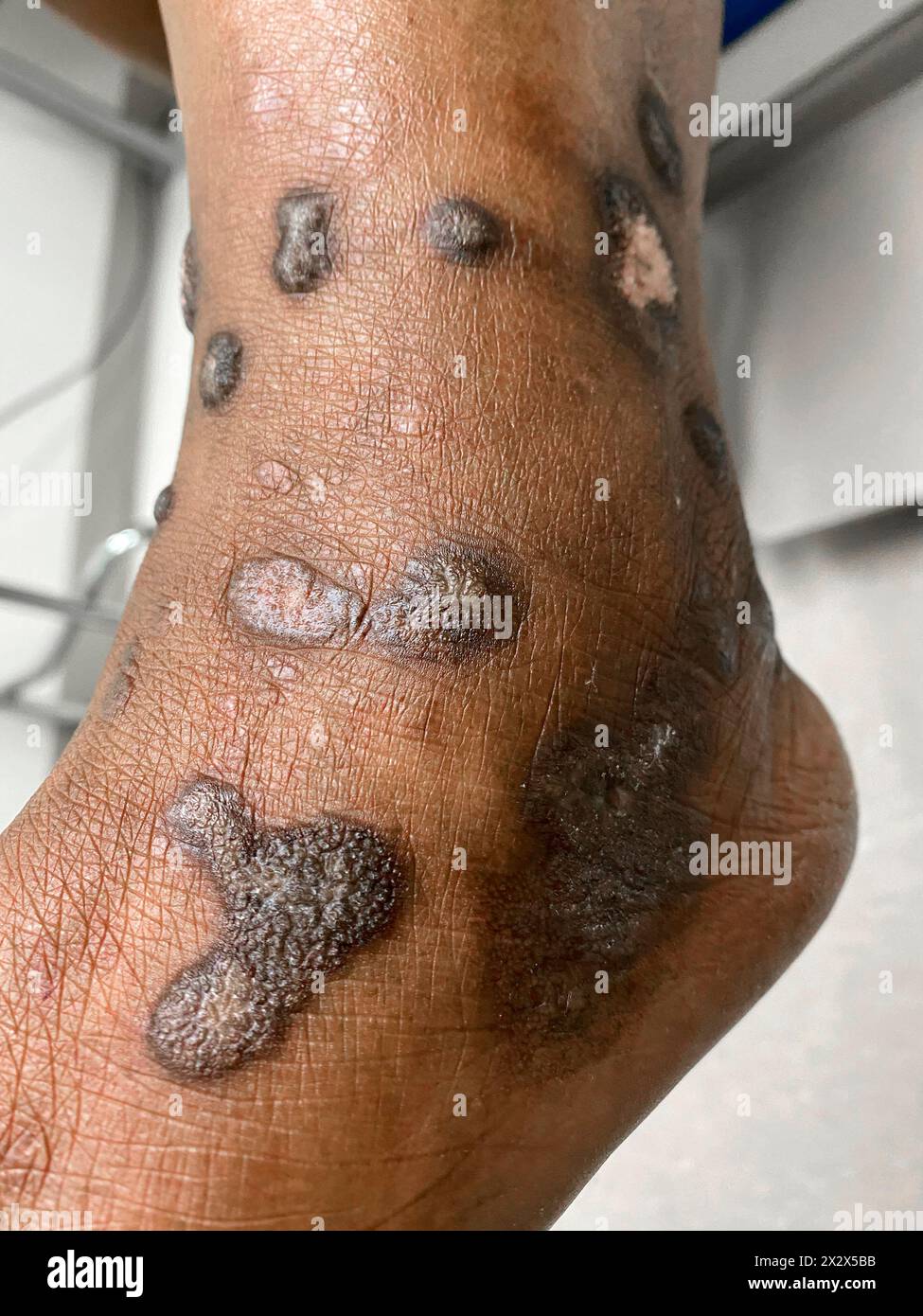 Lichen planus lesions on the foot and ankle of a female African ...