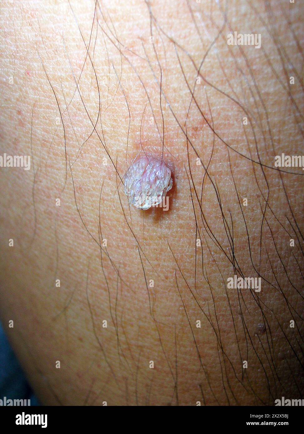 Filiform wart on the arm of a 55 year old male Hispanic patient. Warts ...
