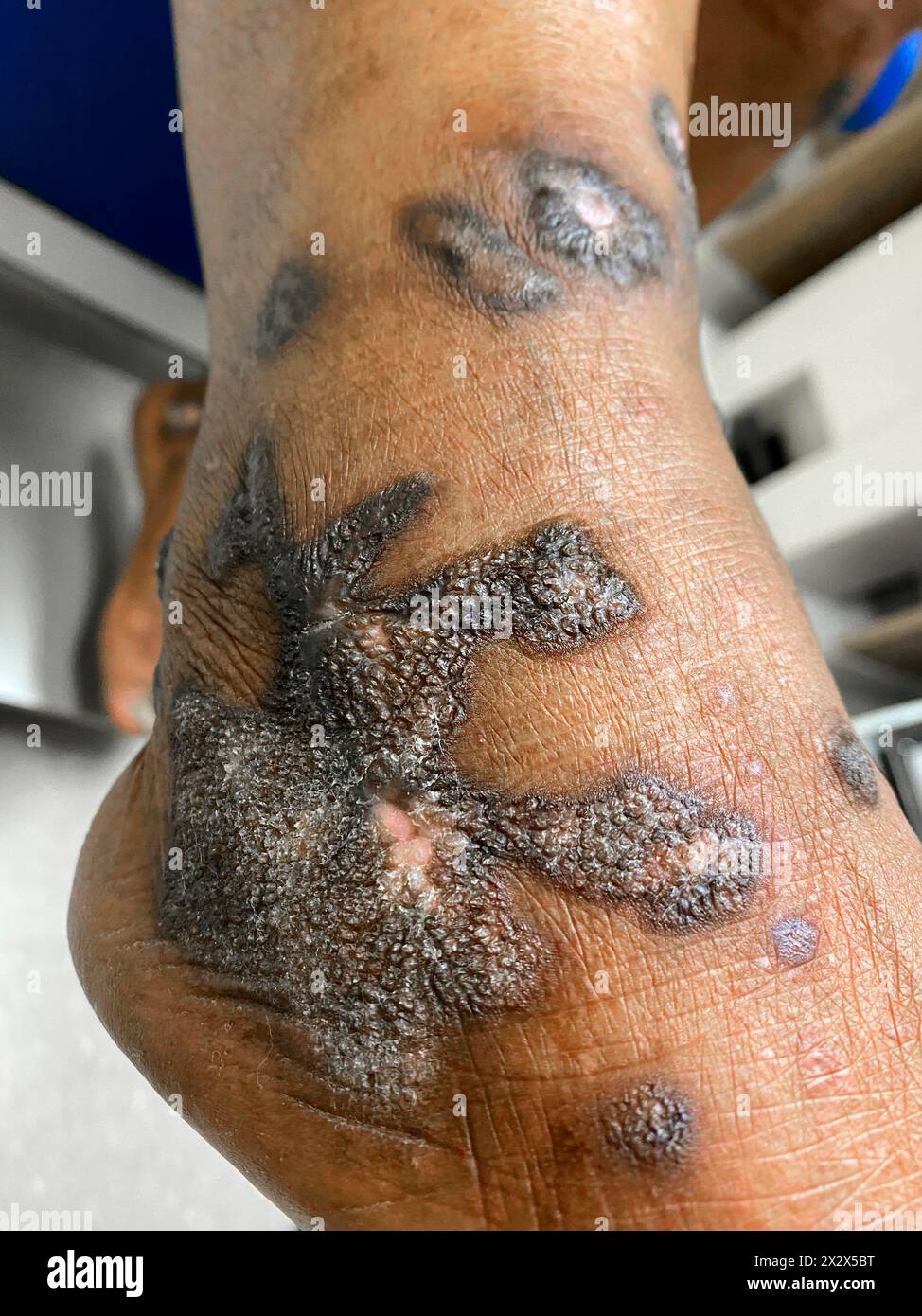 Lichen planus lesions on the foot and ankle of a female African ...