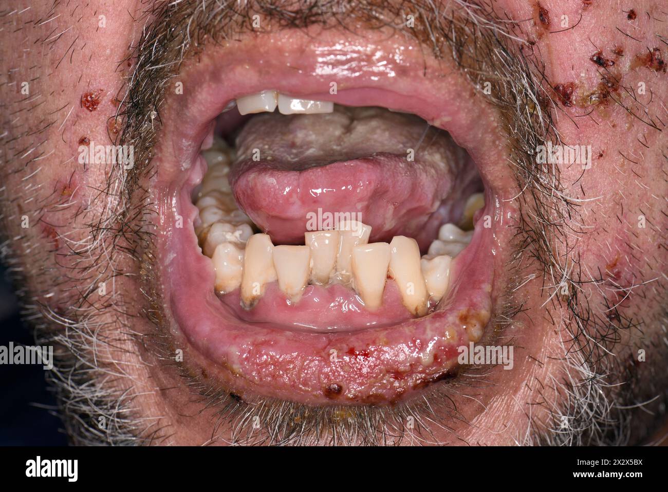 Oral lichen planus. Lichen planus is an inflammatory disorder of the ...