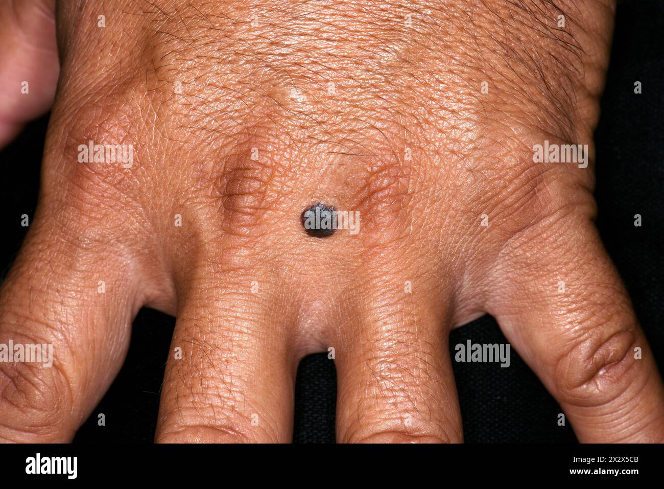 Melanoma on the hand of a 40 year old Hispanic male patient. Melanoma ...