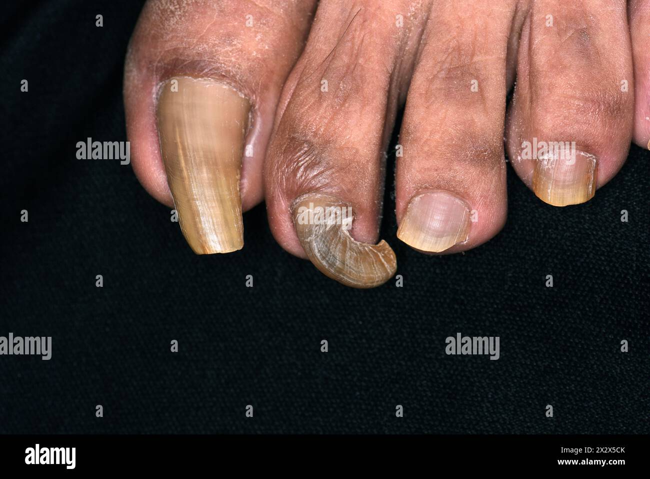 Deformed toenails (onychogryphosis) on a Hispanic male patient's foot ...