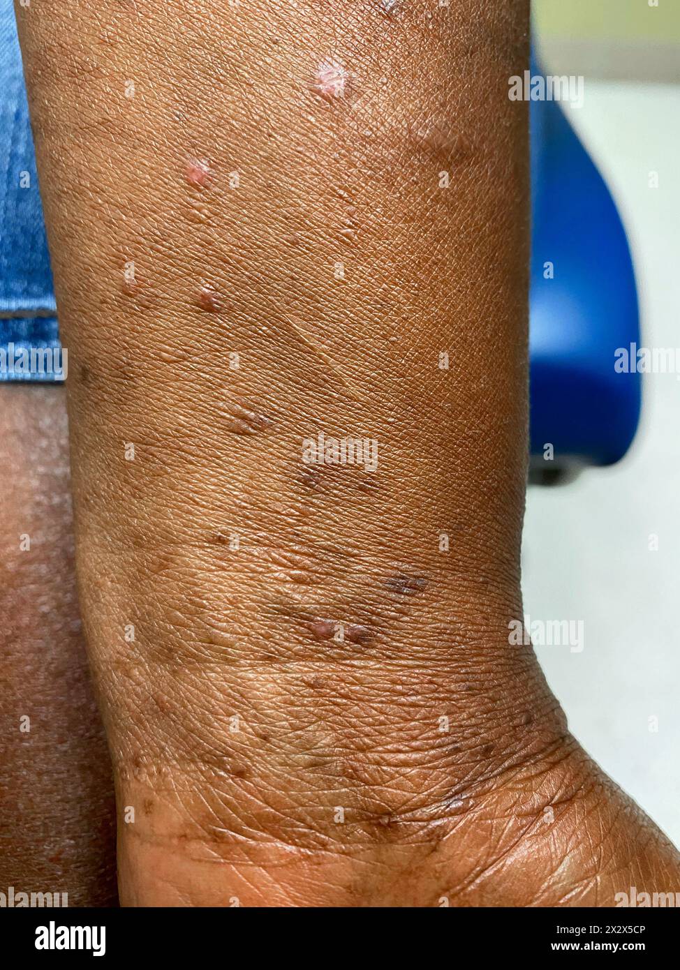 Lichen planus lesions on the arm of a female African American patient ...