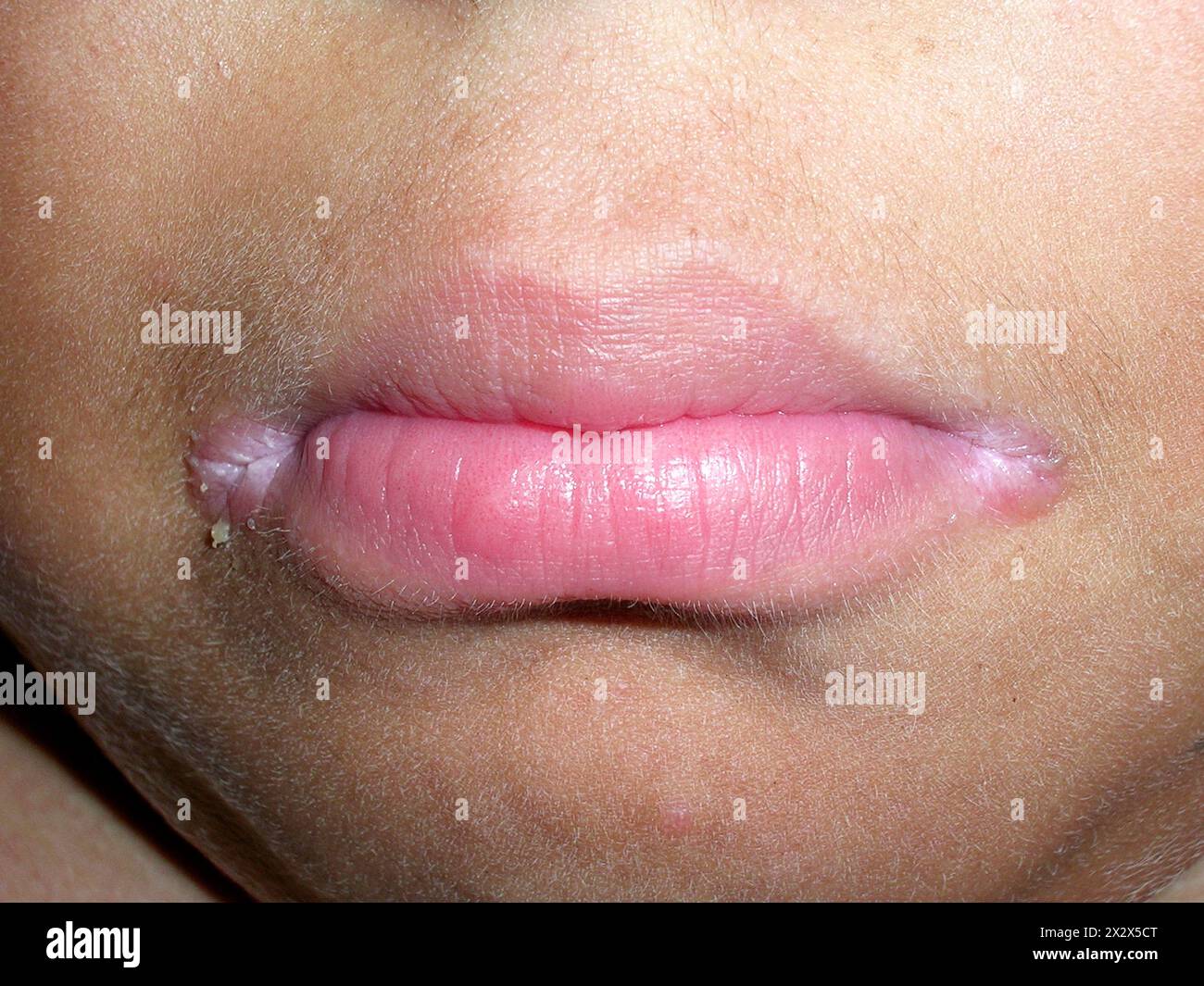 Angular cheilitis, also known as angular stomatitis, is an inflammatory ...