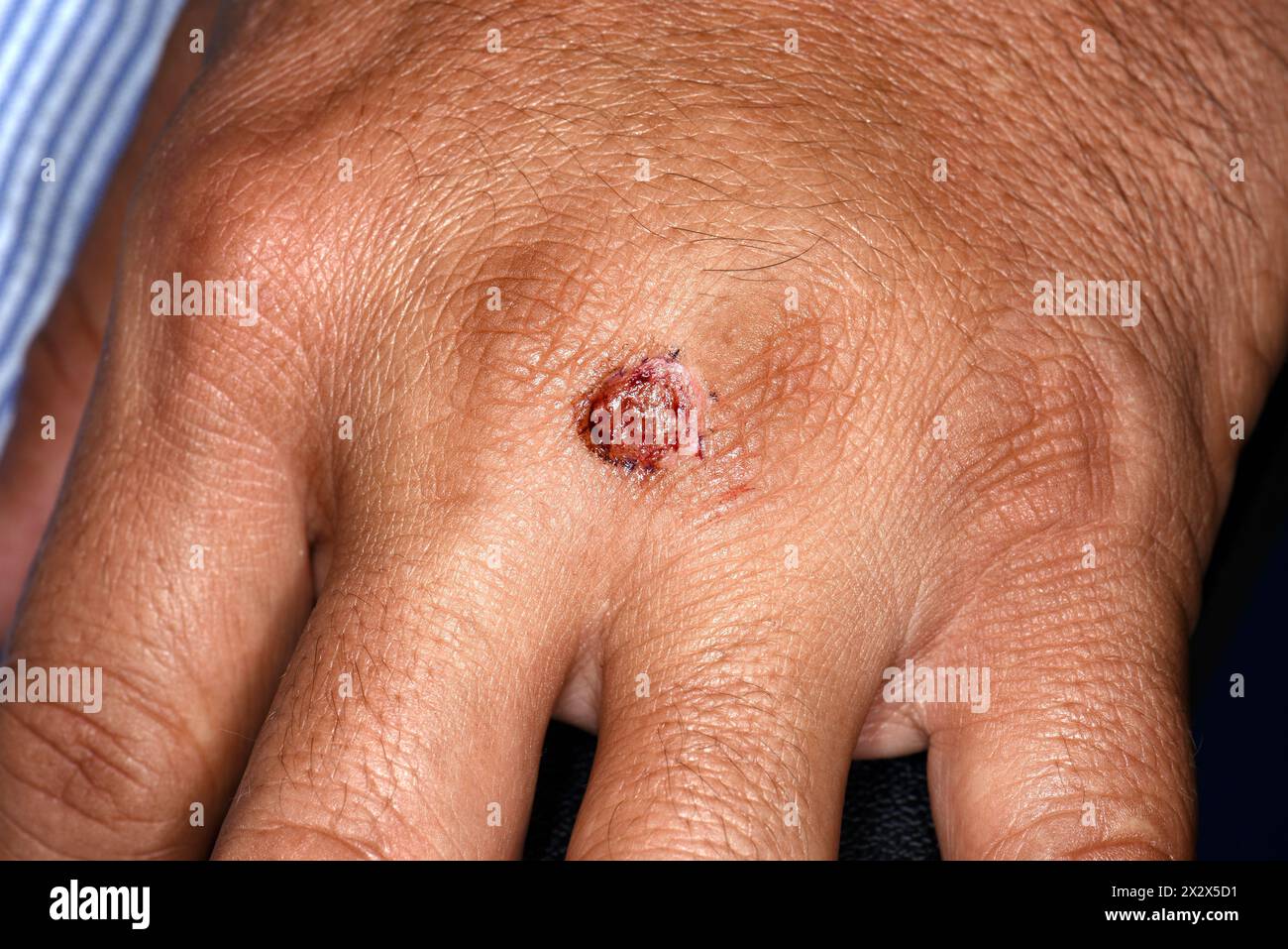Hand of a 40 year old Hispanic male patient after a shave biopsy of a ...