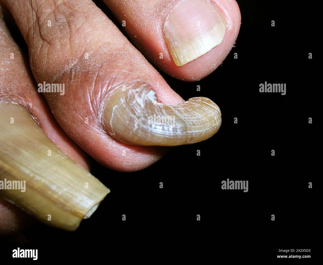 Deformed toenails (onychogryphosis) on a Hispanic male patient's foot ...