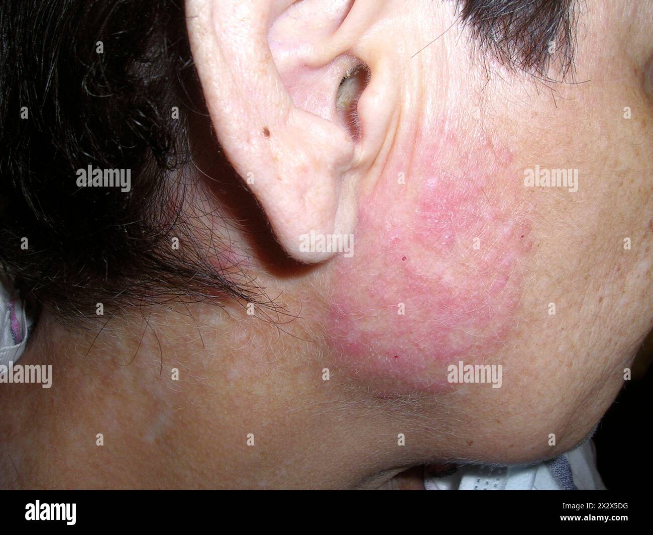 Ringworm infection on a Hispanic female patient's face. Ringworm is a ...
