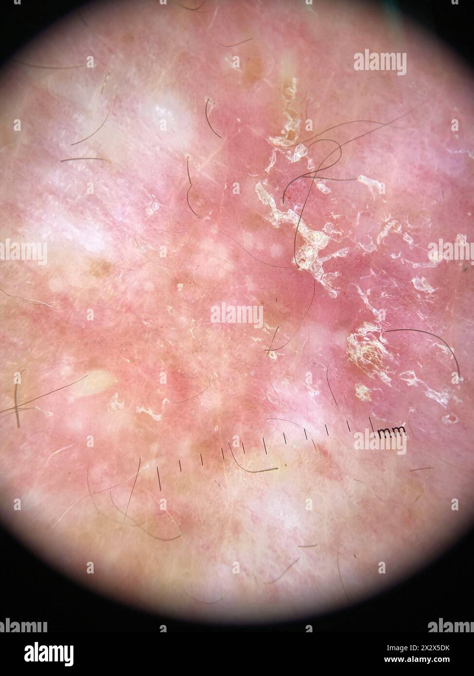 Dermatoscope image of a ringworm infection on a Hispanic female patient ...