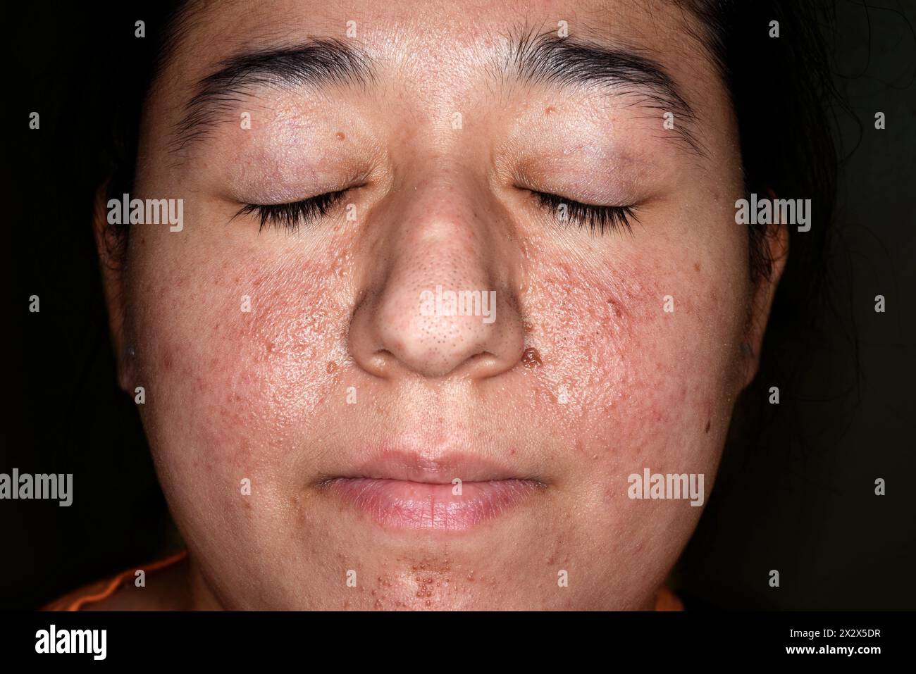 Face of a patient with skin lesions (cutaneous angiofibromas) caused by ...