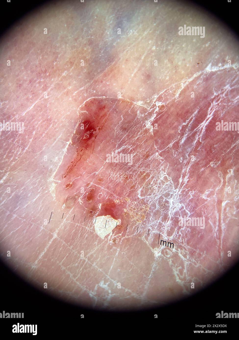 Dermatoscope image of an athlete's foot in a Hispanic female patient ...