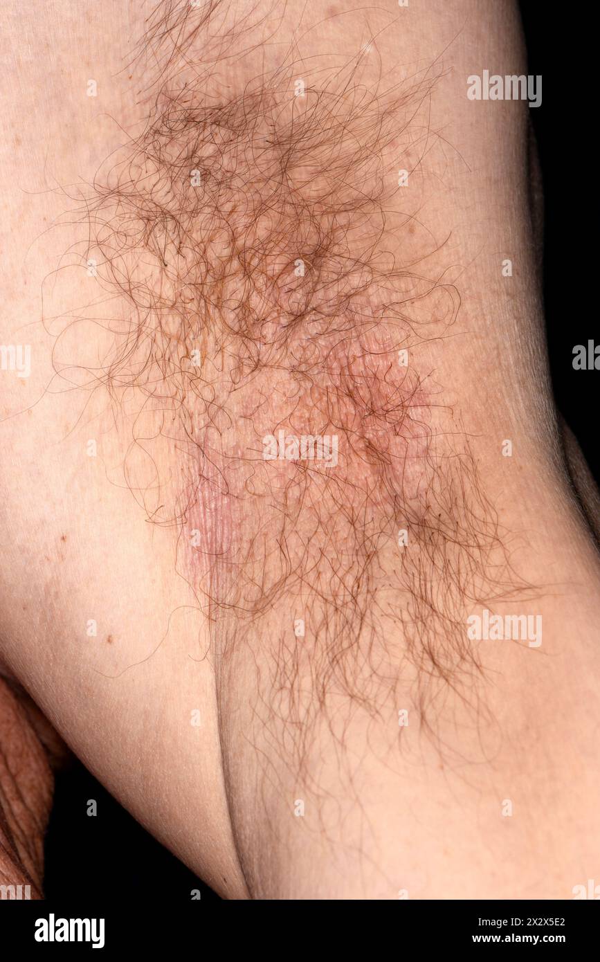 Trichomycosis and erythrasma in the armpit of a 70 year old white ...