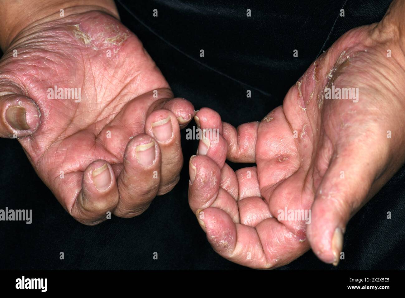 Ringworm infection on a Hispanic female patient's hands. Ringworm is a ...