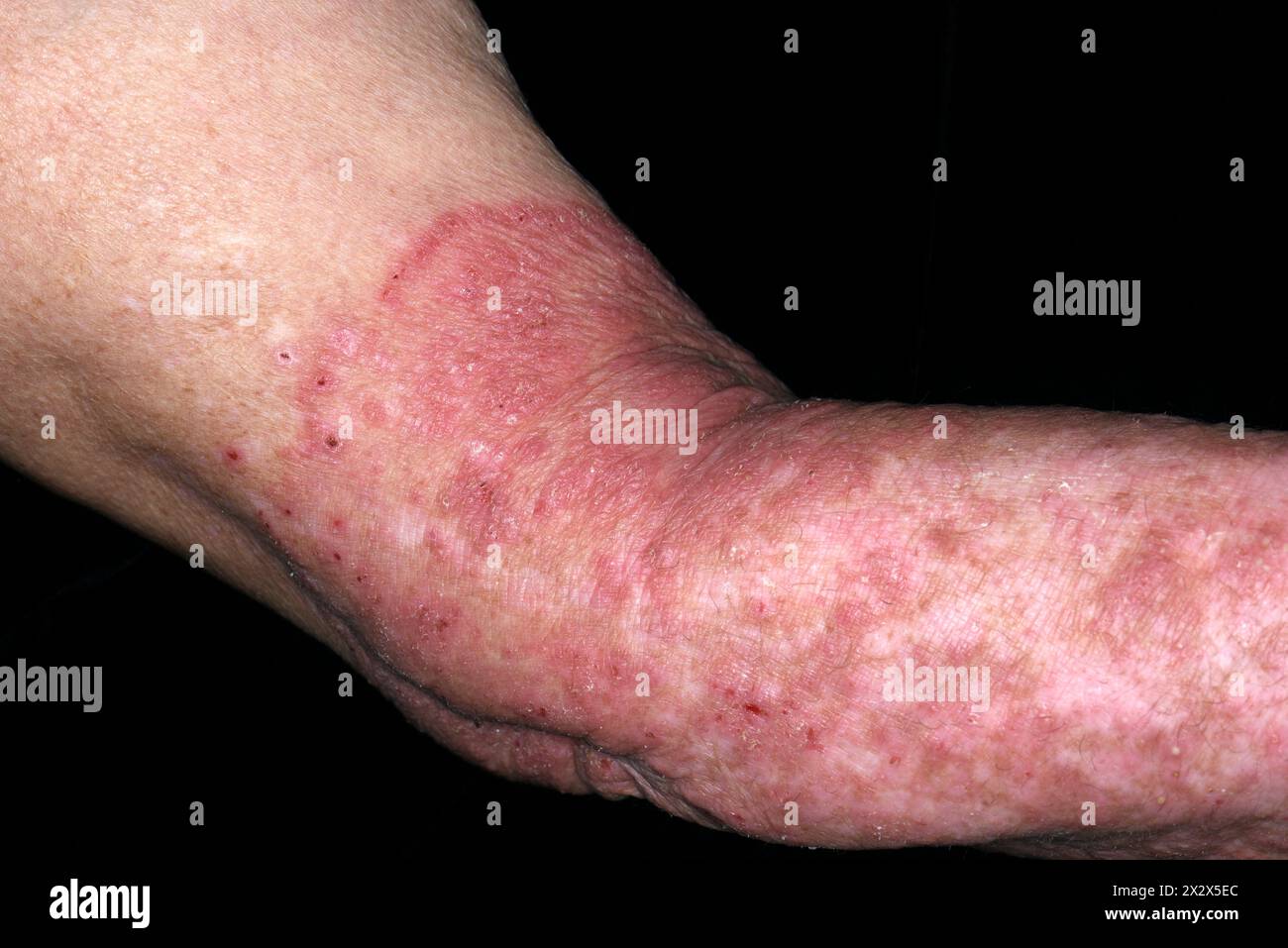 Ringworm infection on a Hispanic female patient's arm. Ringworm is a ...
