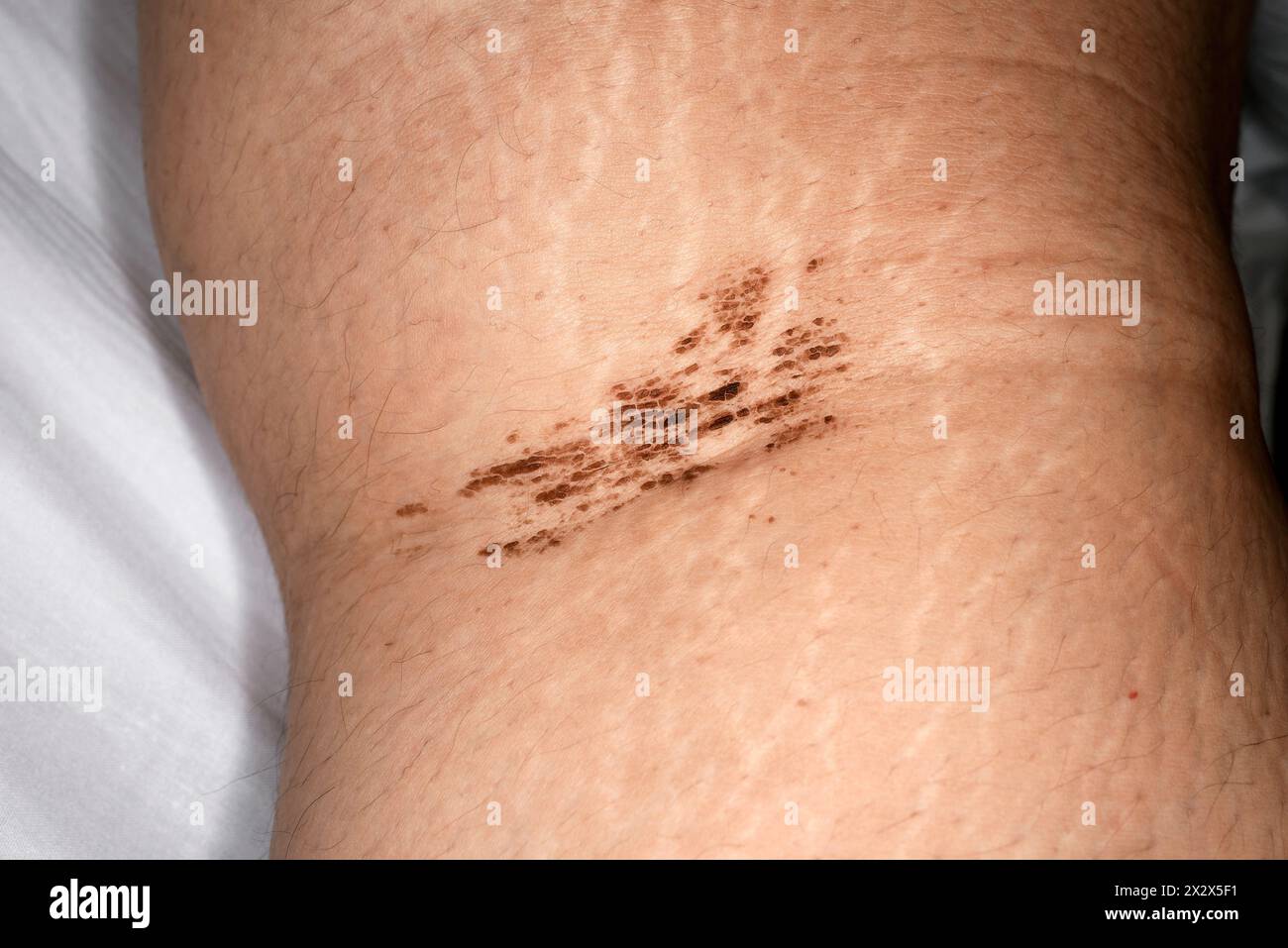 Terra-firma forme dermatosis on the arm of a 33 year old female ...