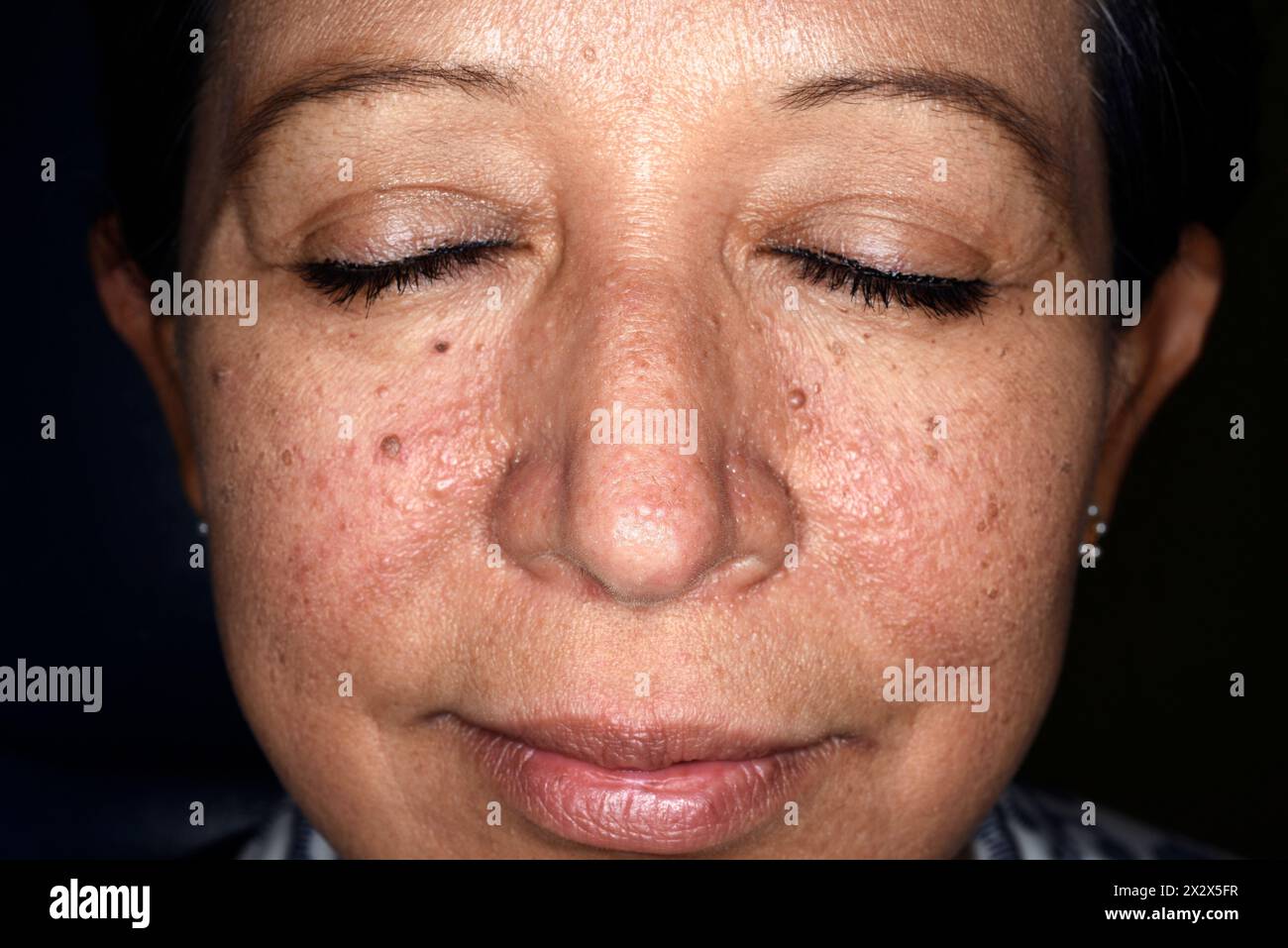 Face of a patient with skin lesions (cutaneous angiofibromas) caused by ...