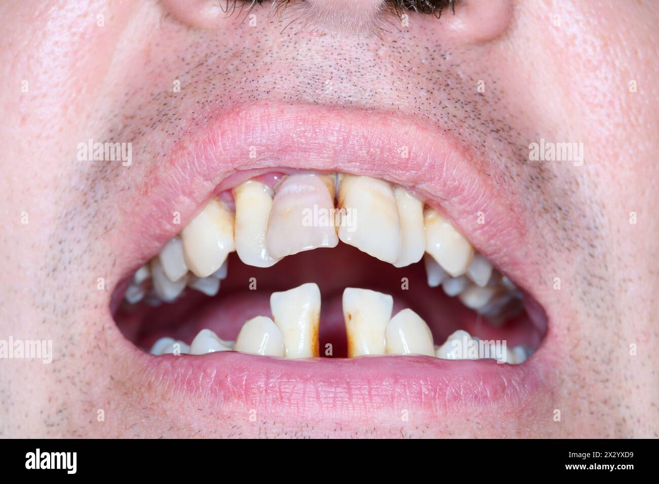 Periodontitis men hi-res stock photography and images - Alamy