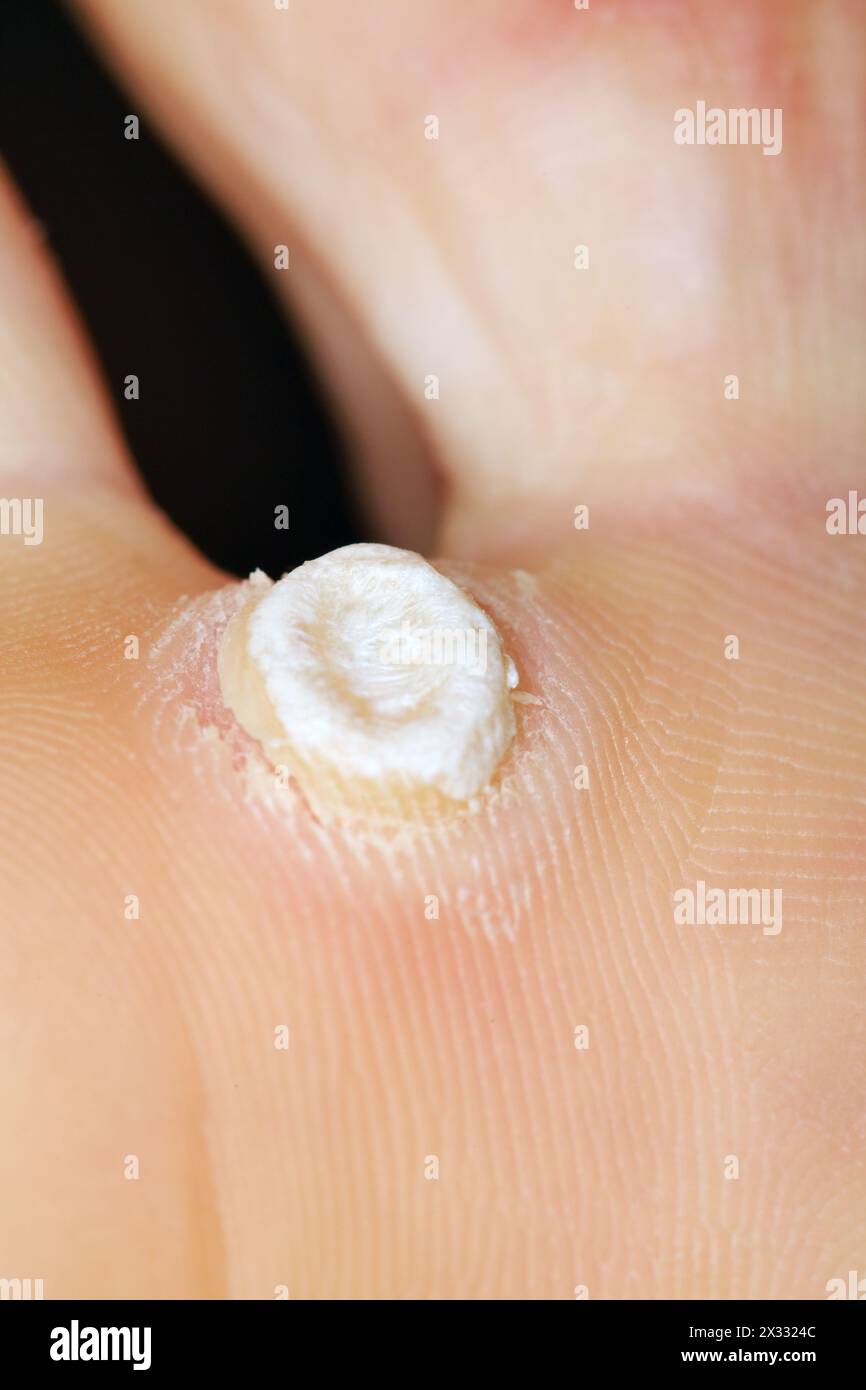Falling off wart on sole of female feet. Wart - benign skin growths of ...