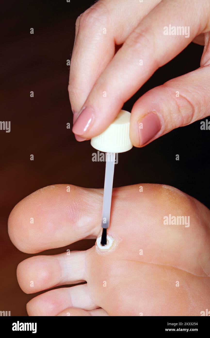 Applying salicylic acid medicine to wart on female feet. Focus on feet ...