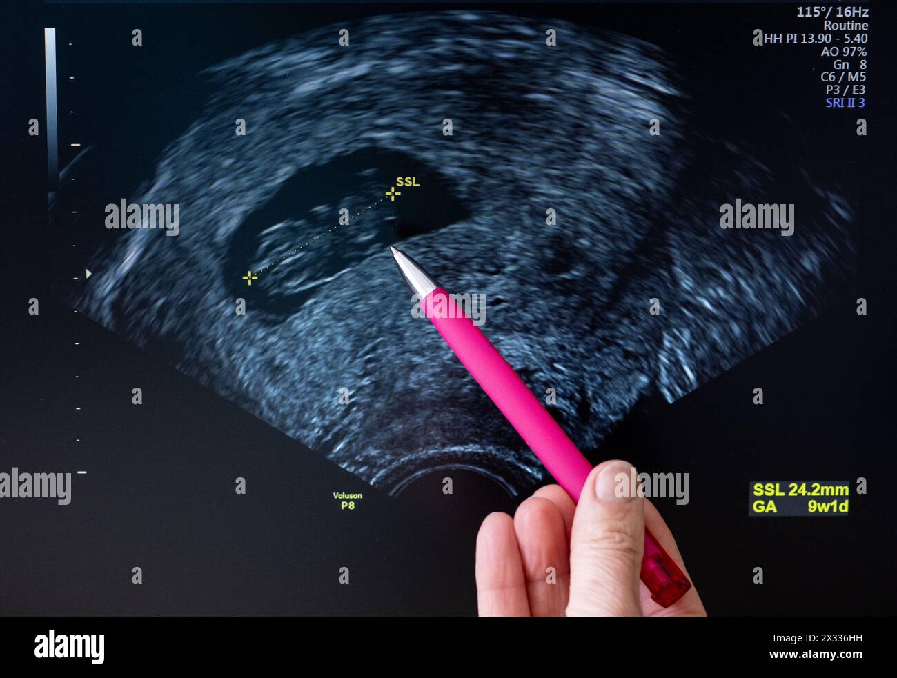 Crown rump length ssl hi-res stock photography and images - Alamy