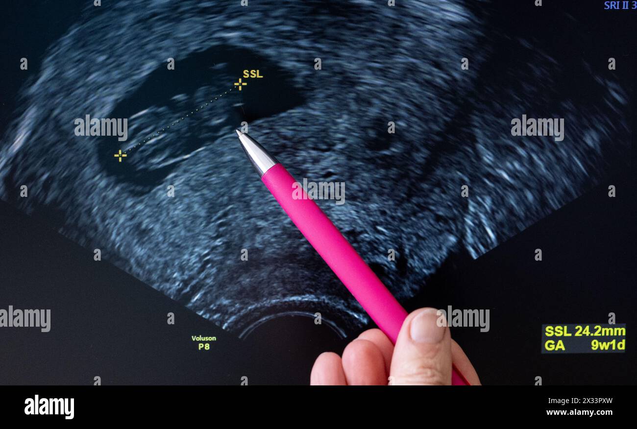Bitterfeld Wolfen, Germany. 24th Apr, 2024. A gynecologist points to ...